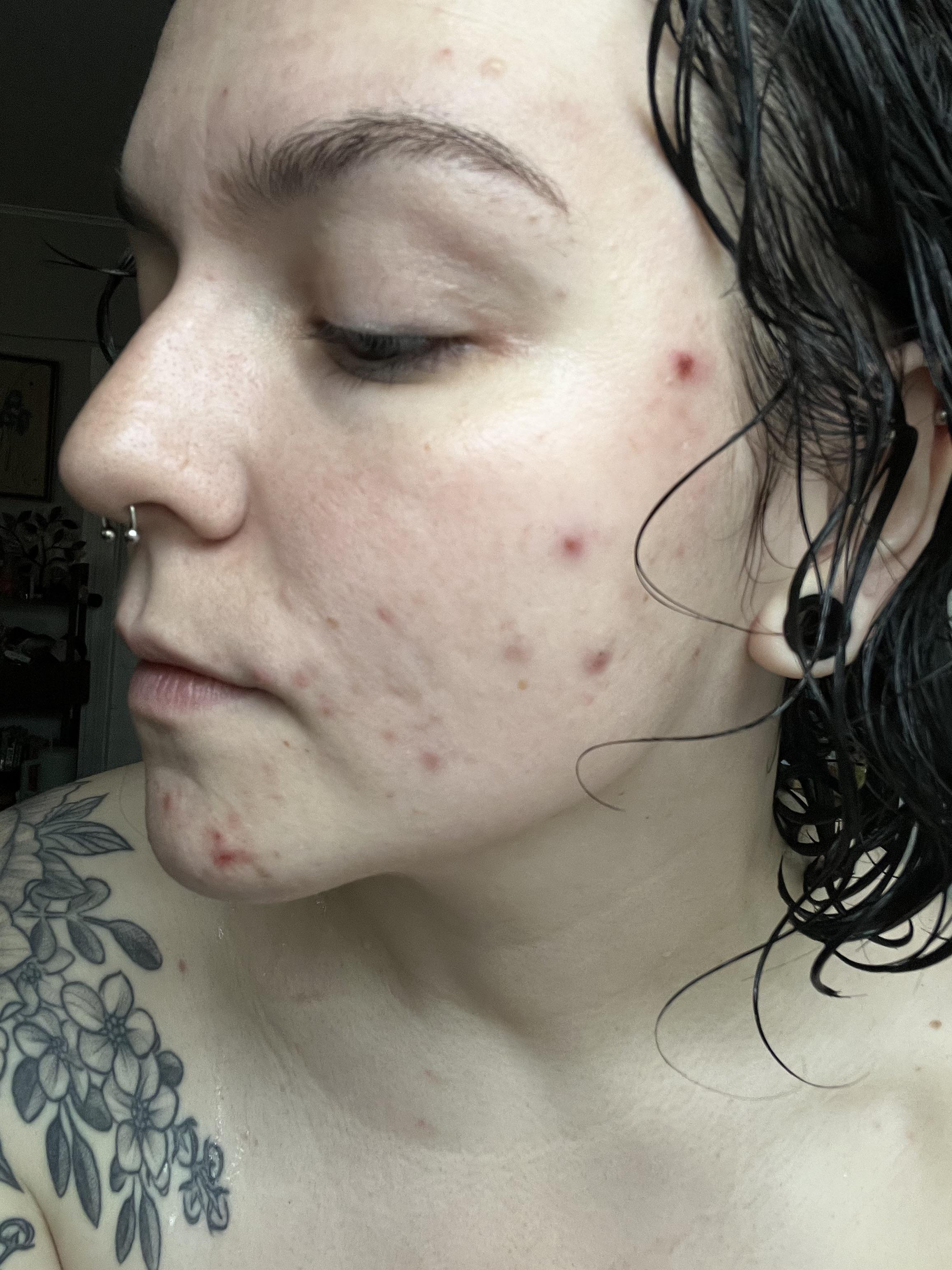 Tips for post picking acne? | Scrolller