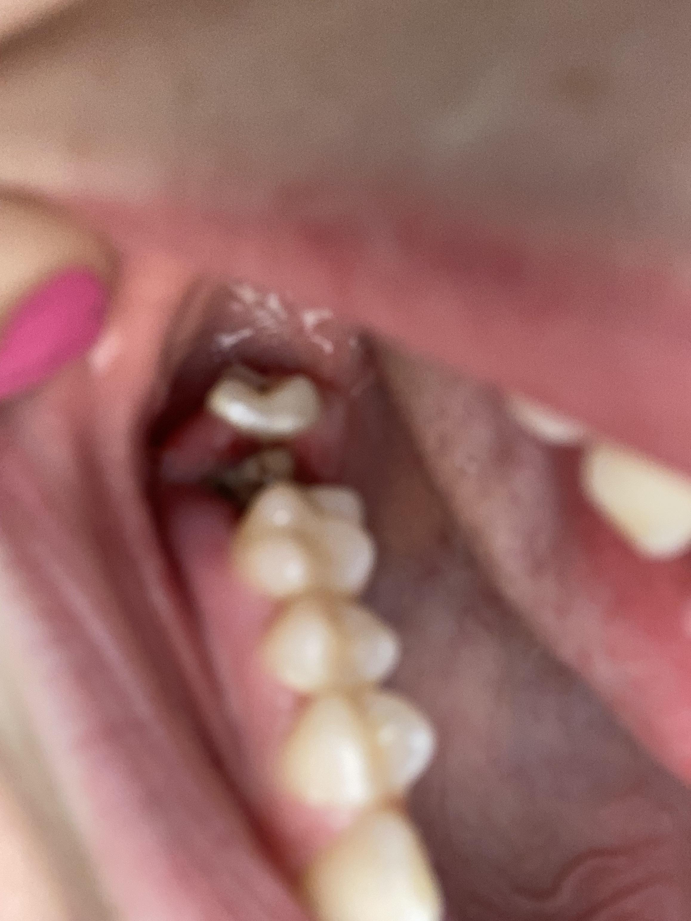 Tooth Extraction | Scrolller