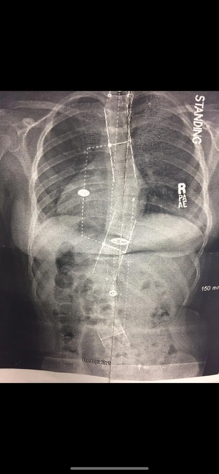 Back popping | Scrolller