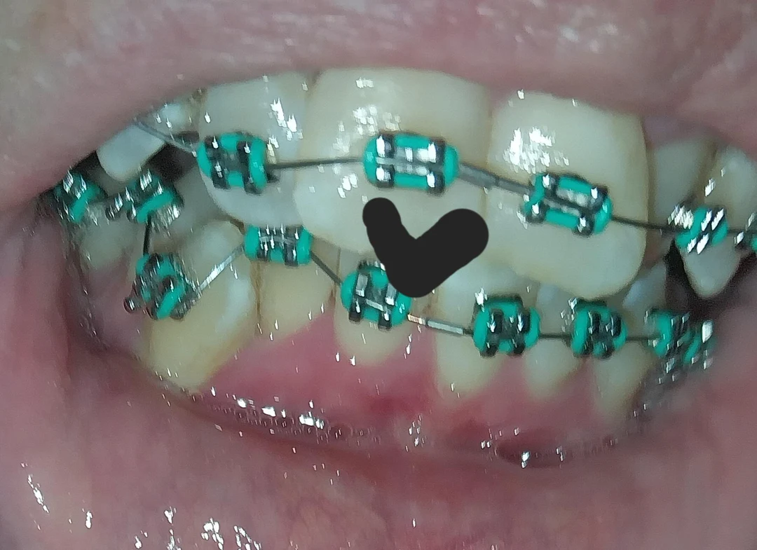 Swelling in the beginning? | Scrolller