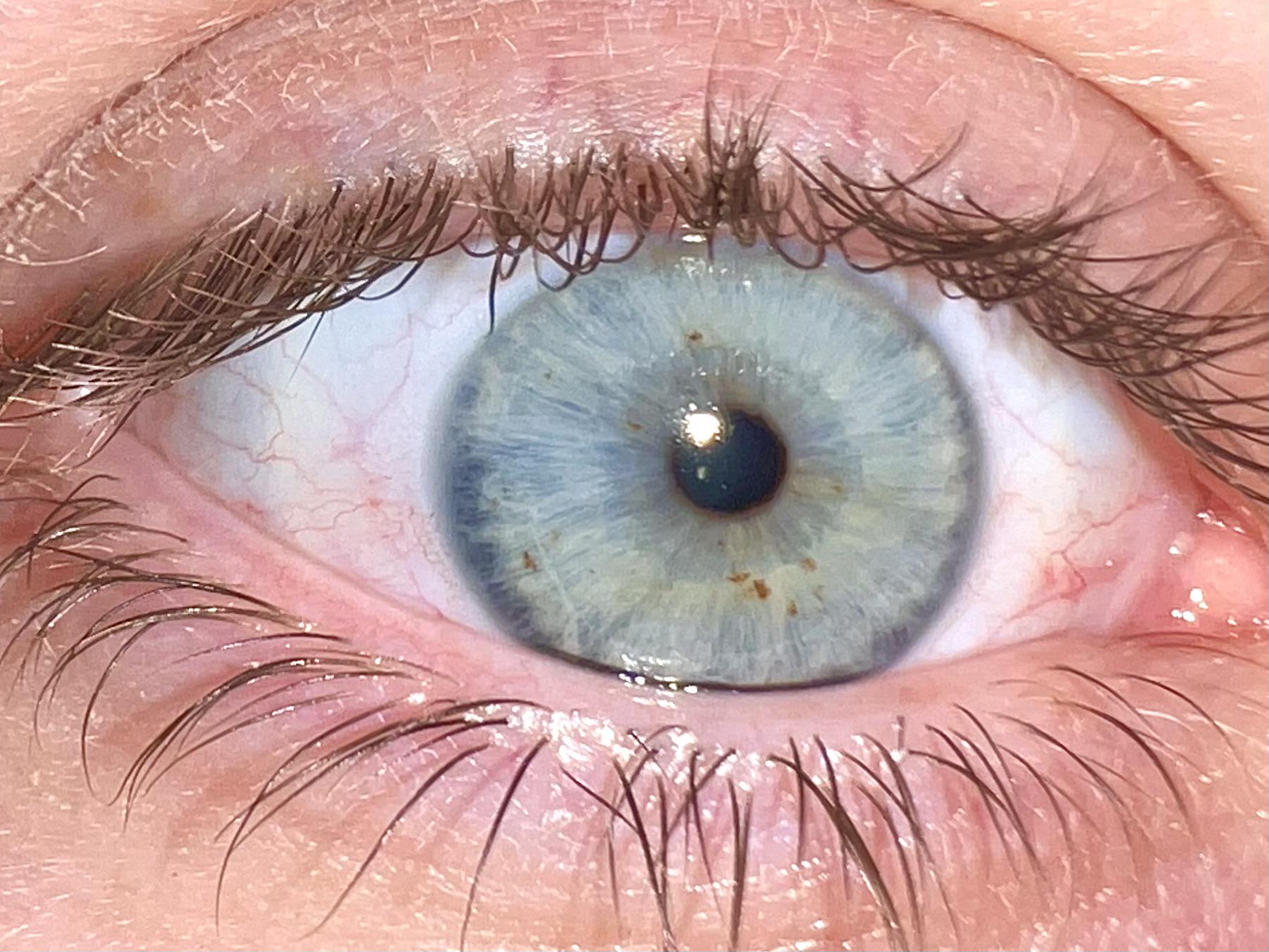 Better photo: freckled eye | Scrolller