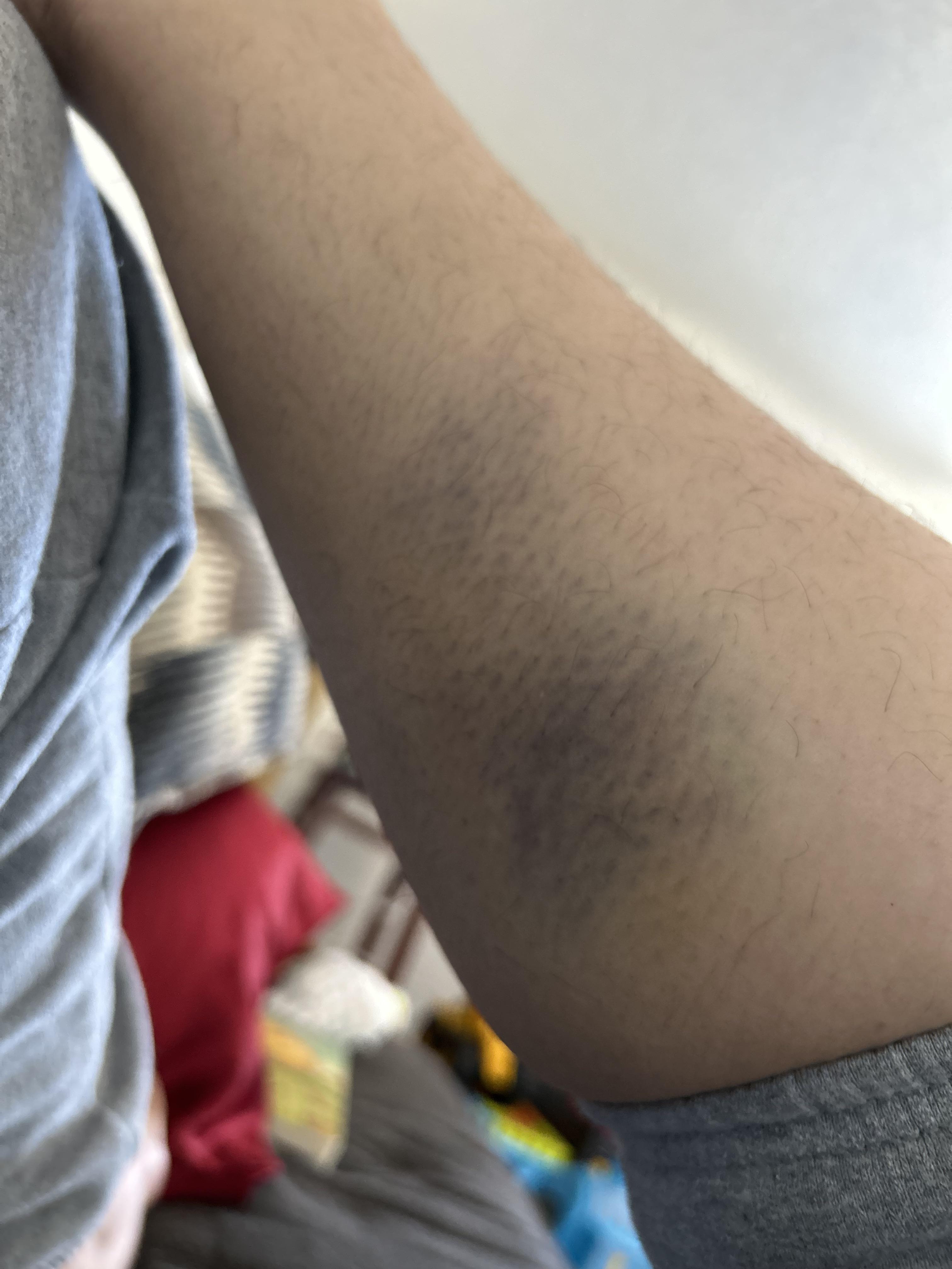 Bruise came back 2 months after injury | Scrolller