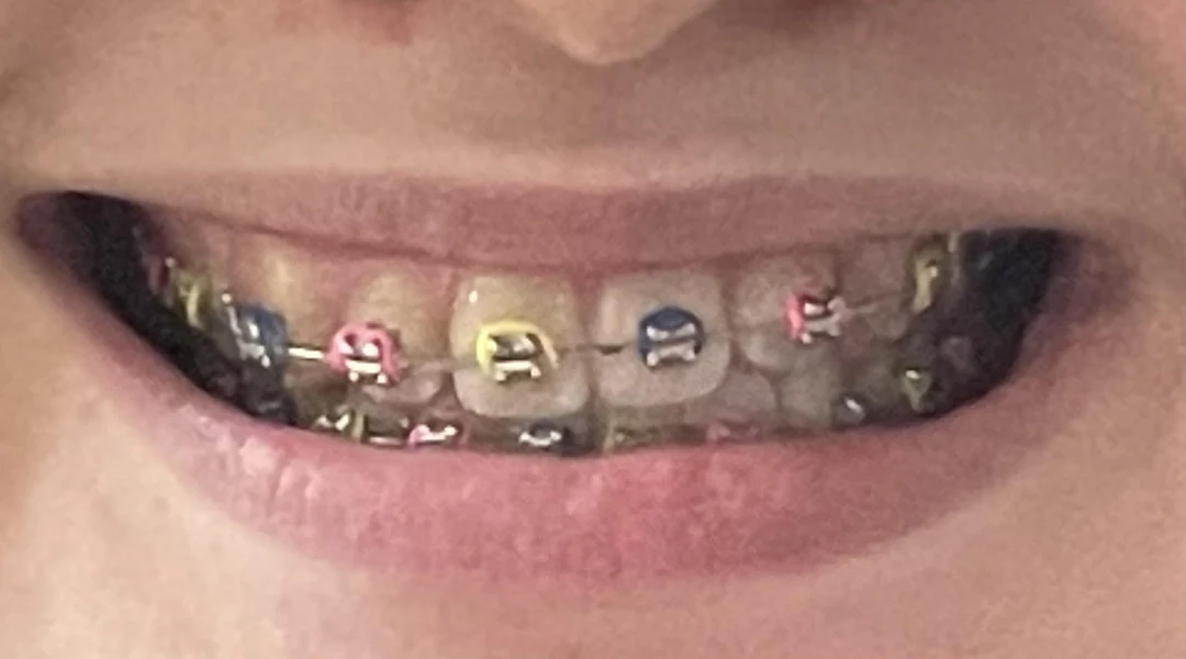 Pan Braces Scrolller