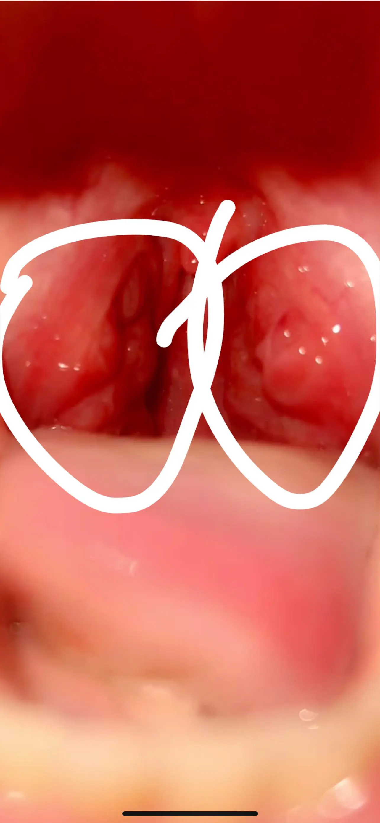 Big tonsils with lumps | Scrolller