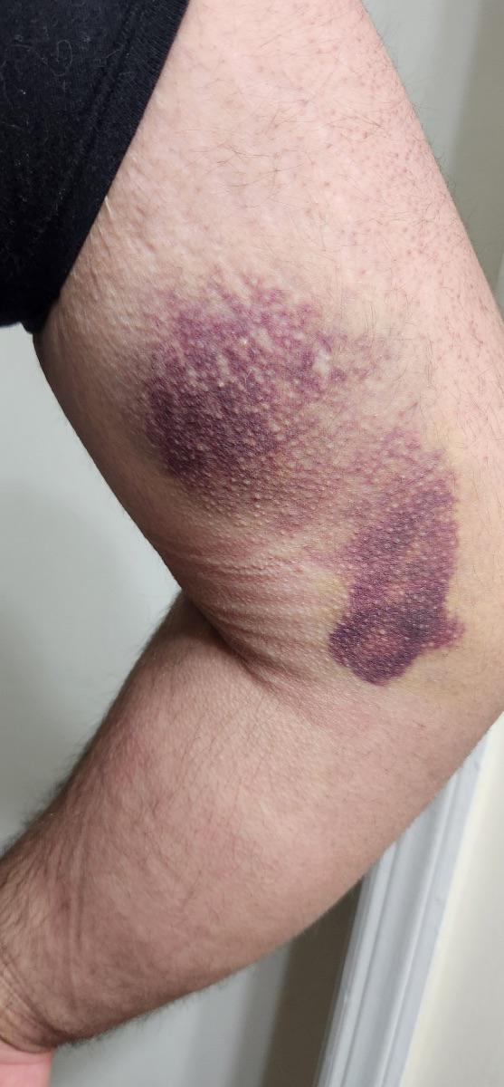 Broke my arm, left a nice bruise | Scrolller