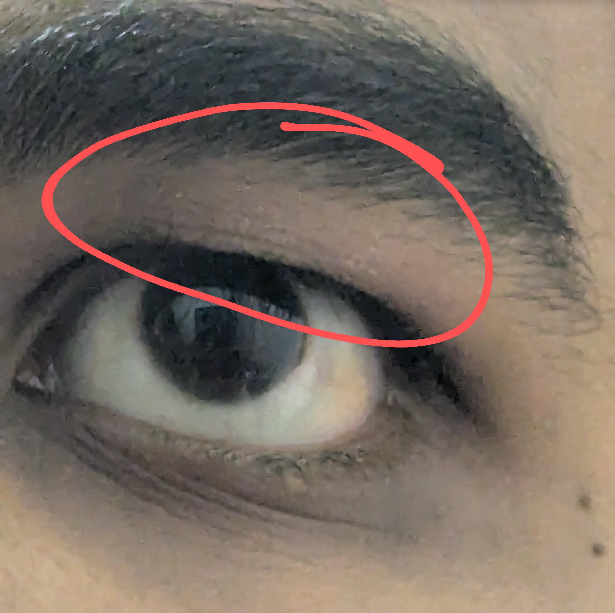 Eye issue | Scrolller