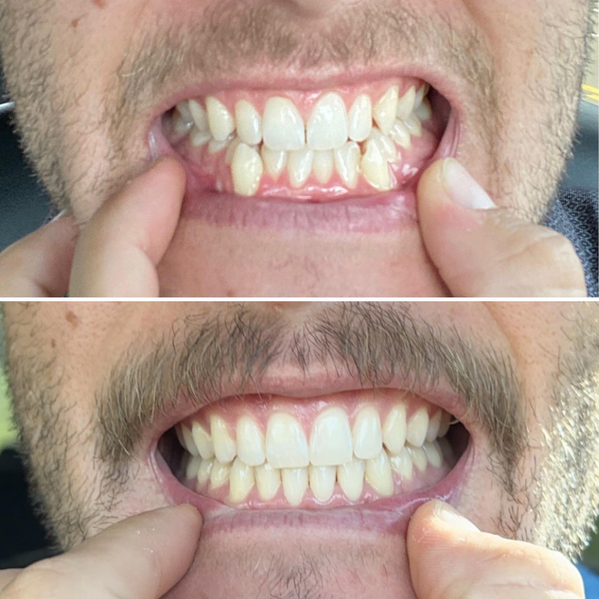 Braces + Jaw Surgery | No extractions! | Scrolller