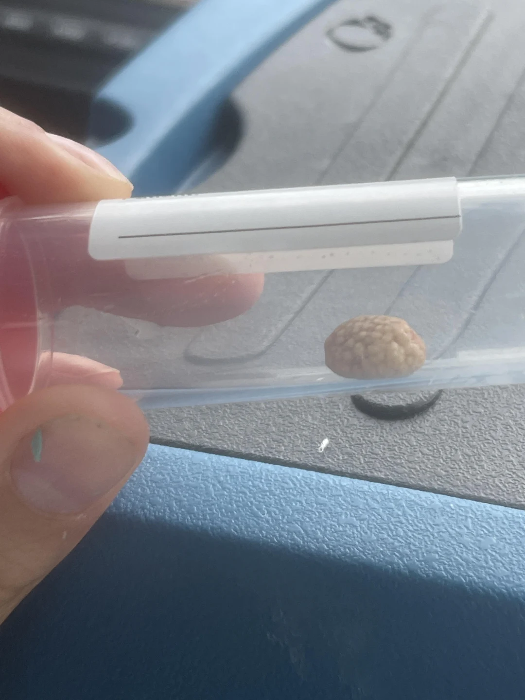 Bladder stones removed :) | Scrolller