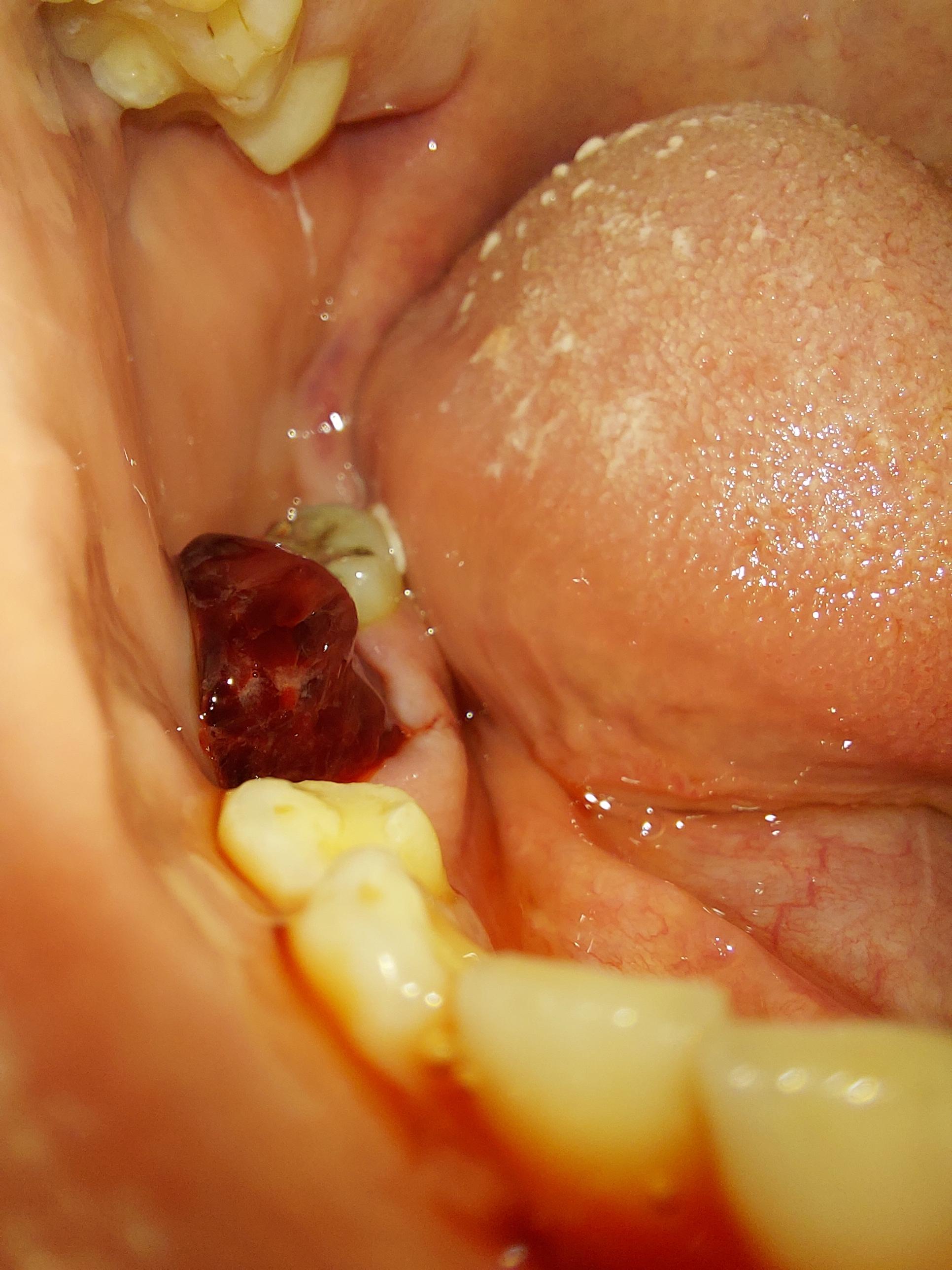 I've had tooth extractions before and never had anything like this happen. | Scrolller