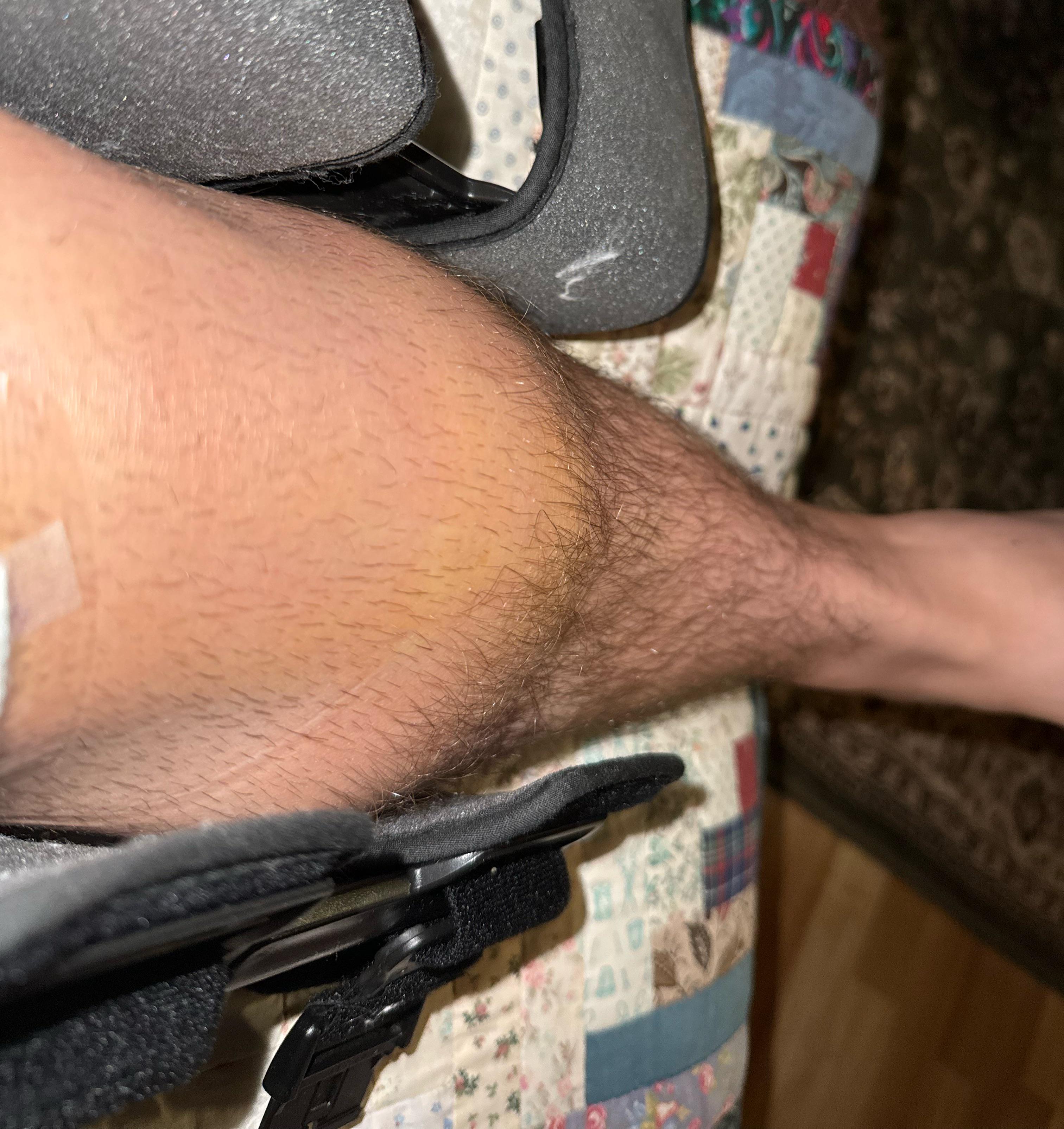 Got knee surgery recently and the swelling of my leg lines up with the leg brace I wear | Scrolller