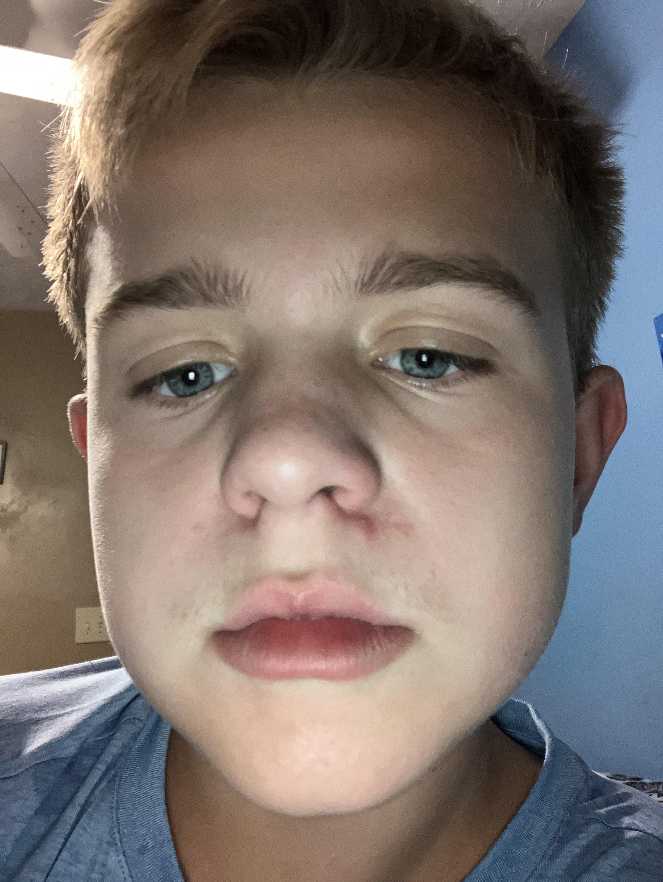 Painful bump | Scrolller