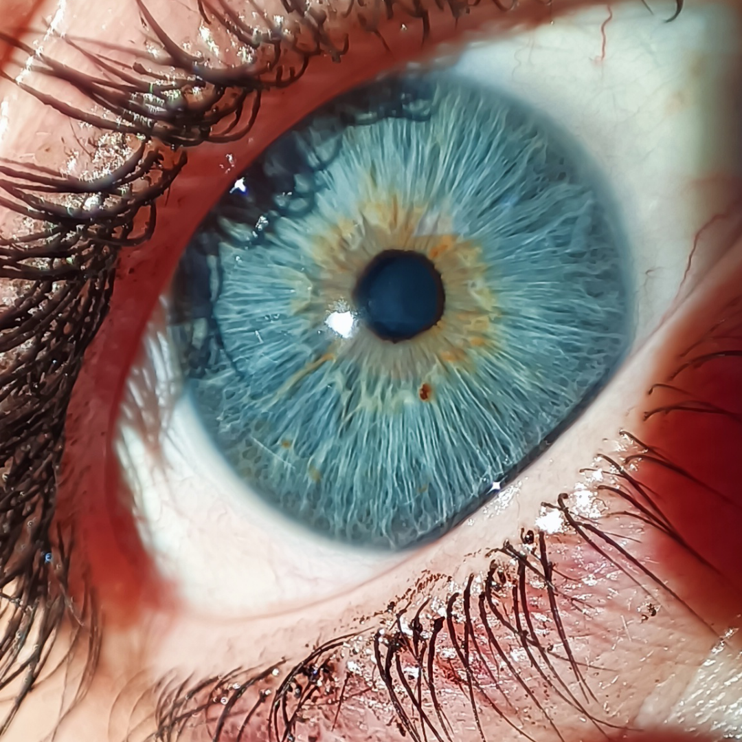 Central heterochromia? | Scrolller