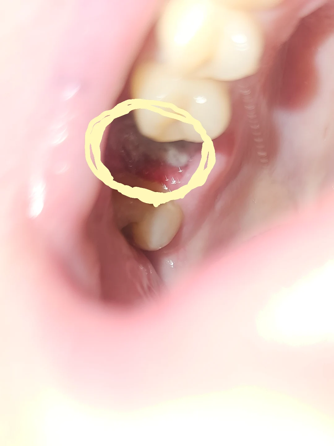 2.5 days after tooth extraction. Is this granulation tissue? Should i stop doing salt water ...
