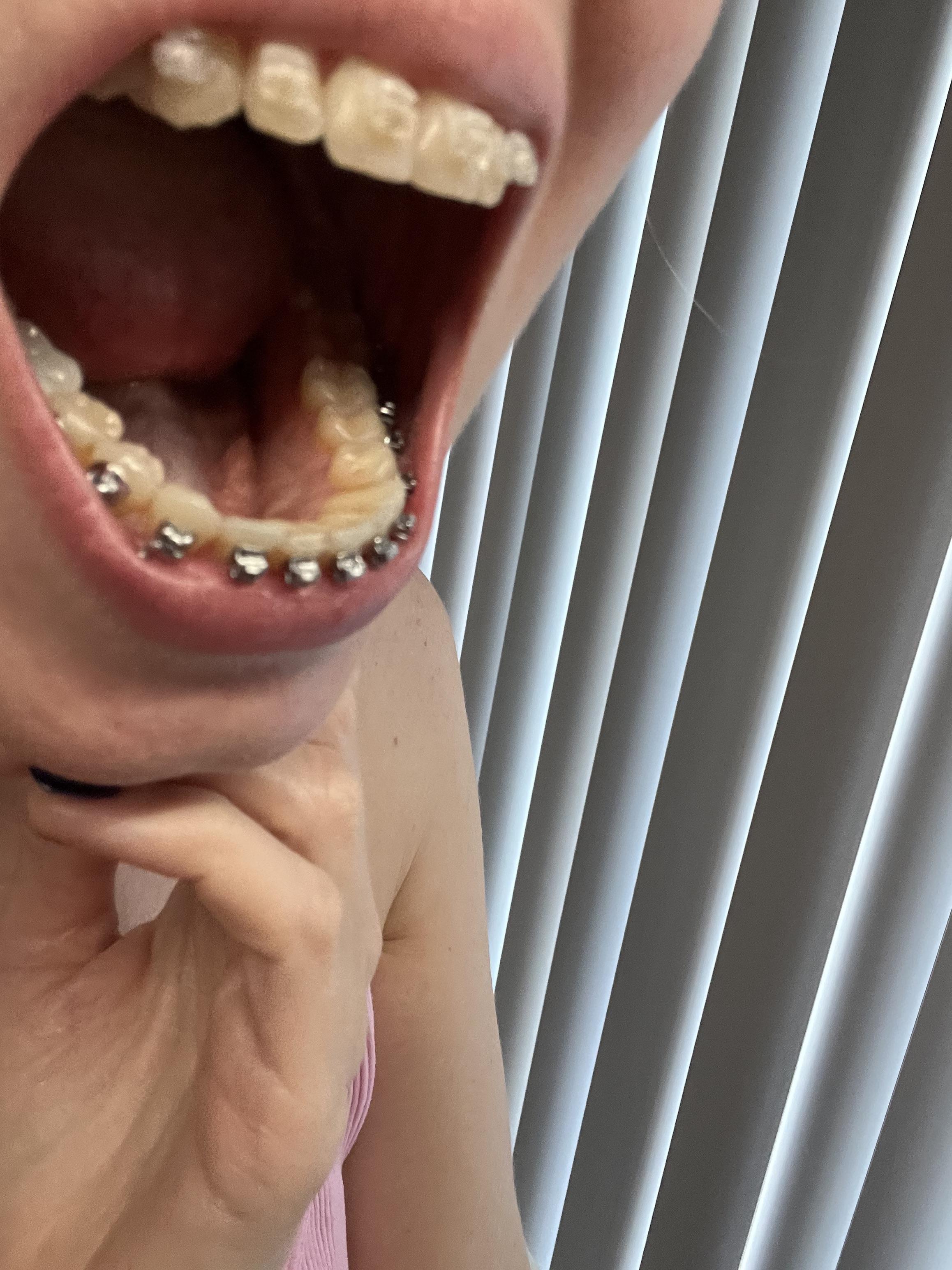 Flared teeth during beaces | Scrolller