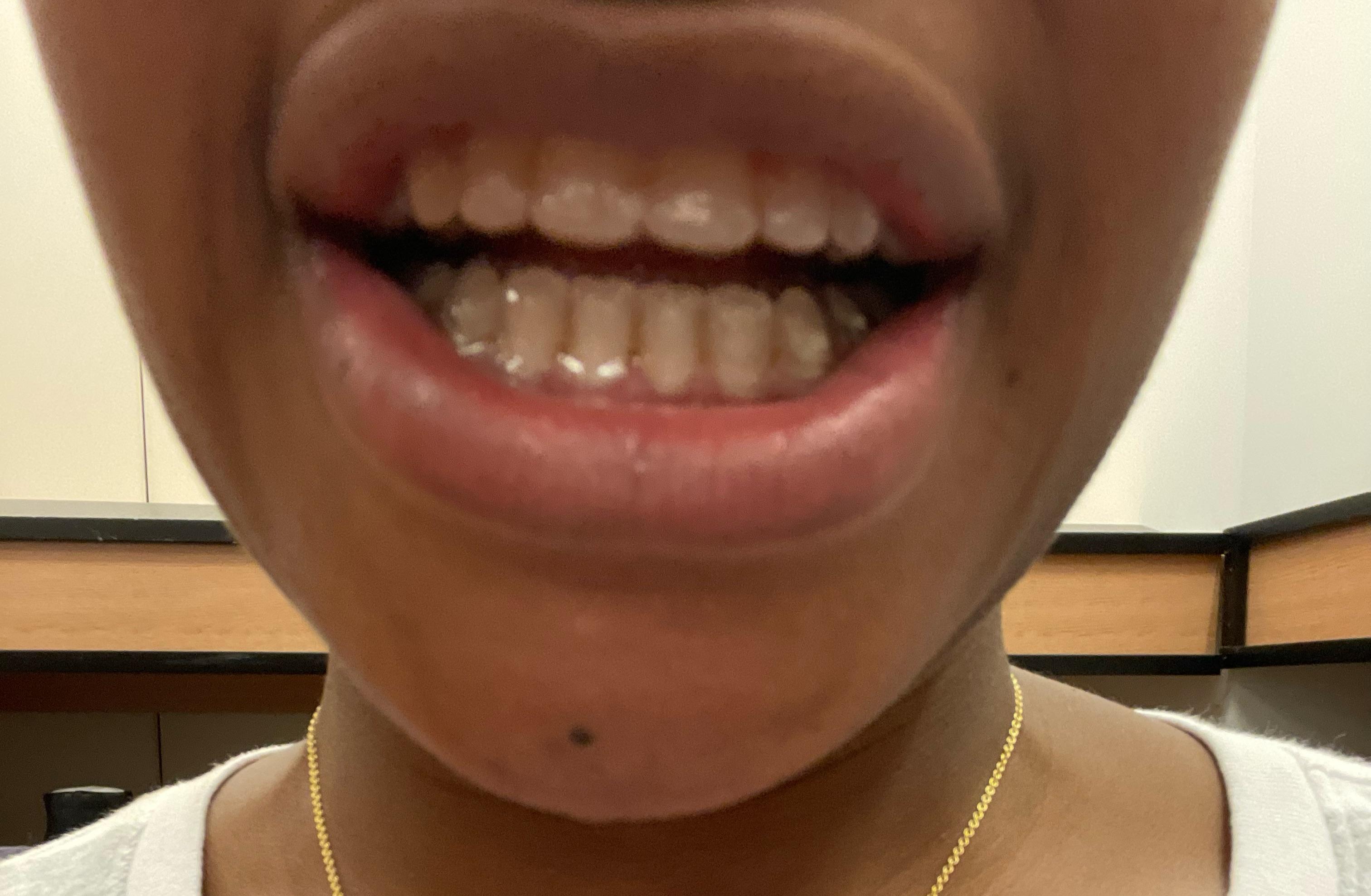 Just got my Retainers | Scrolller