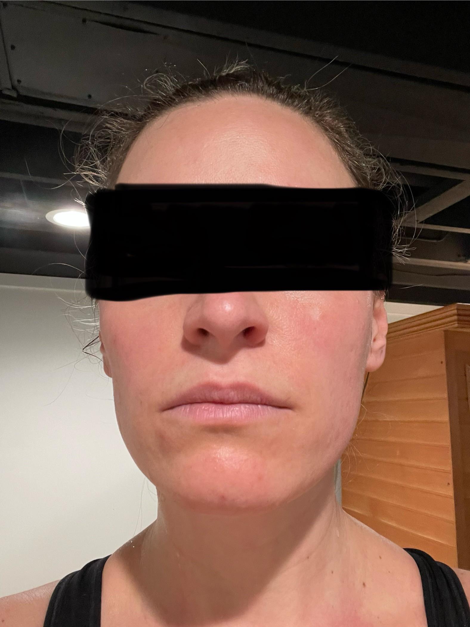 Facial redness | Scrolller