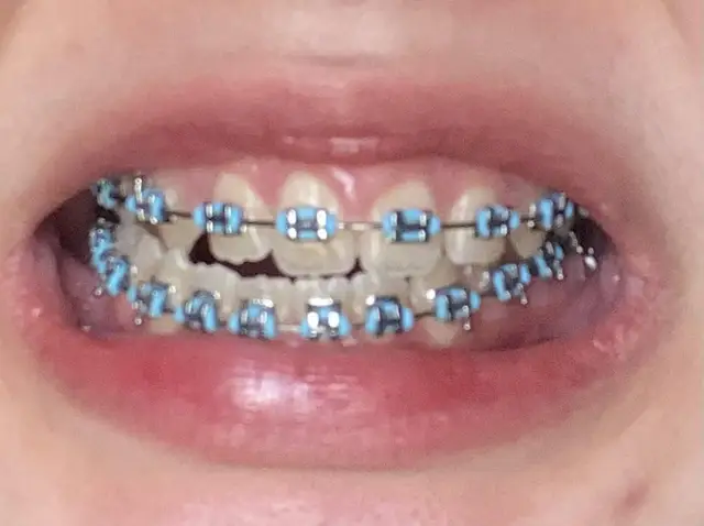 Doesn’t braces correct midline? Or is my case different/severe? | Scrolller