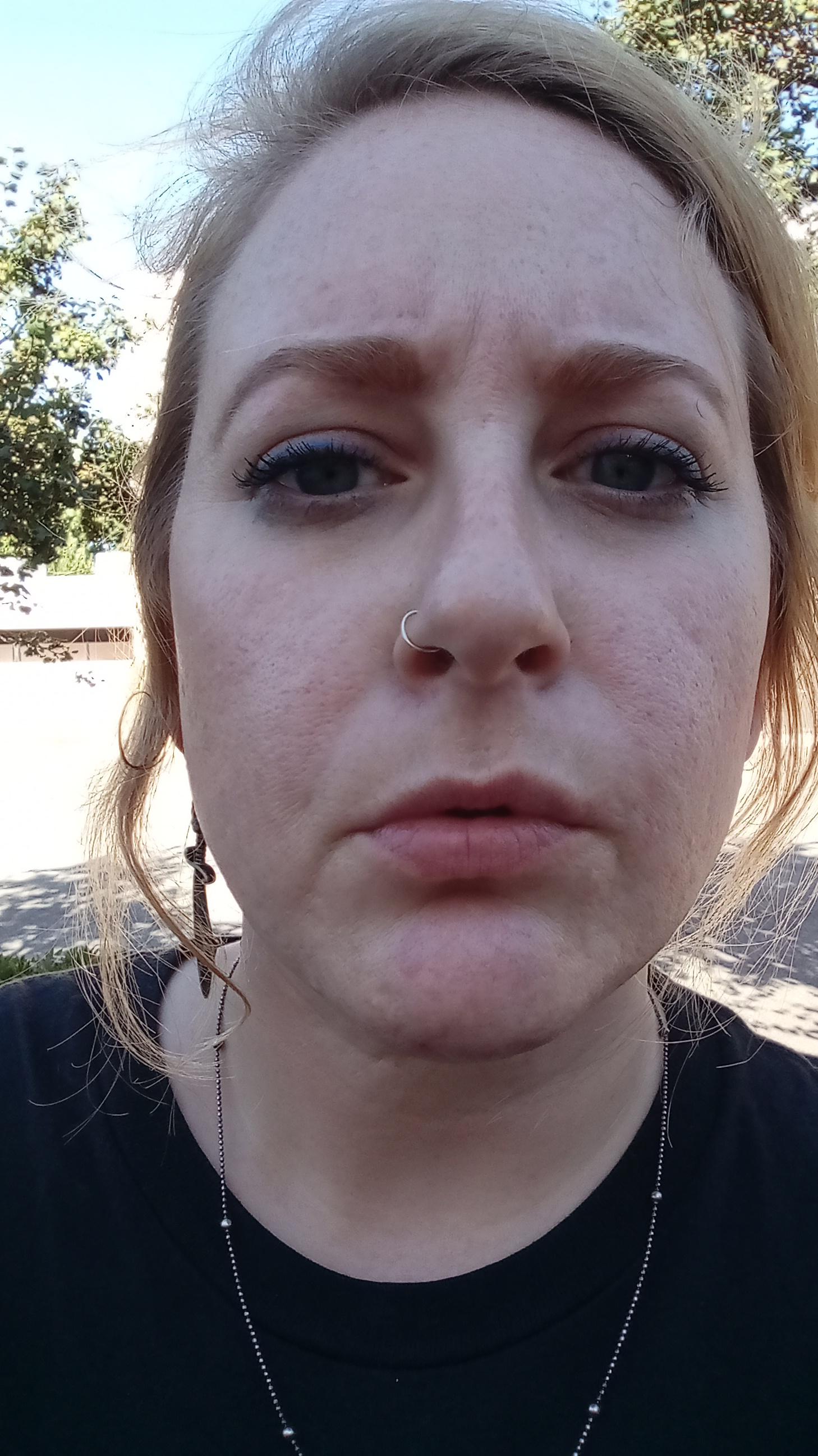 Huge pore scars | Scrolller