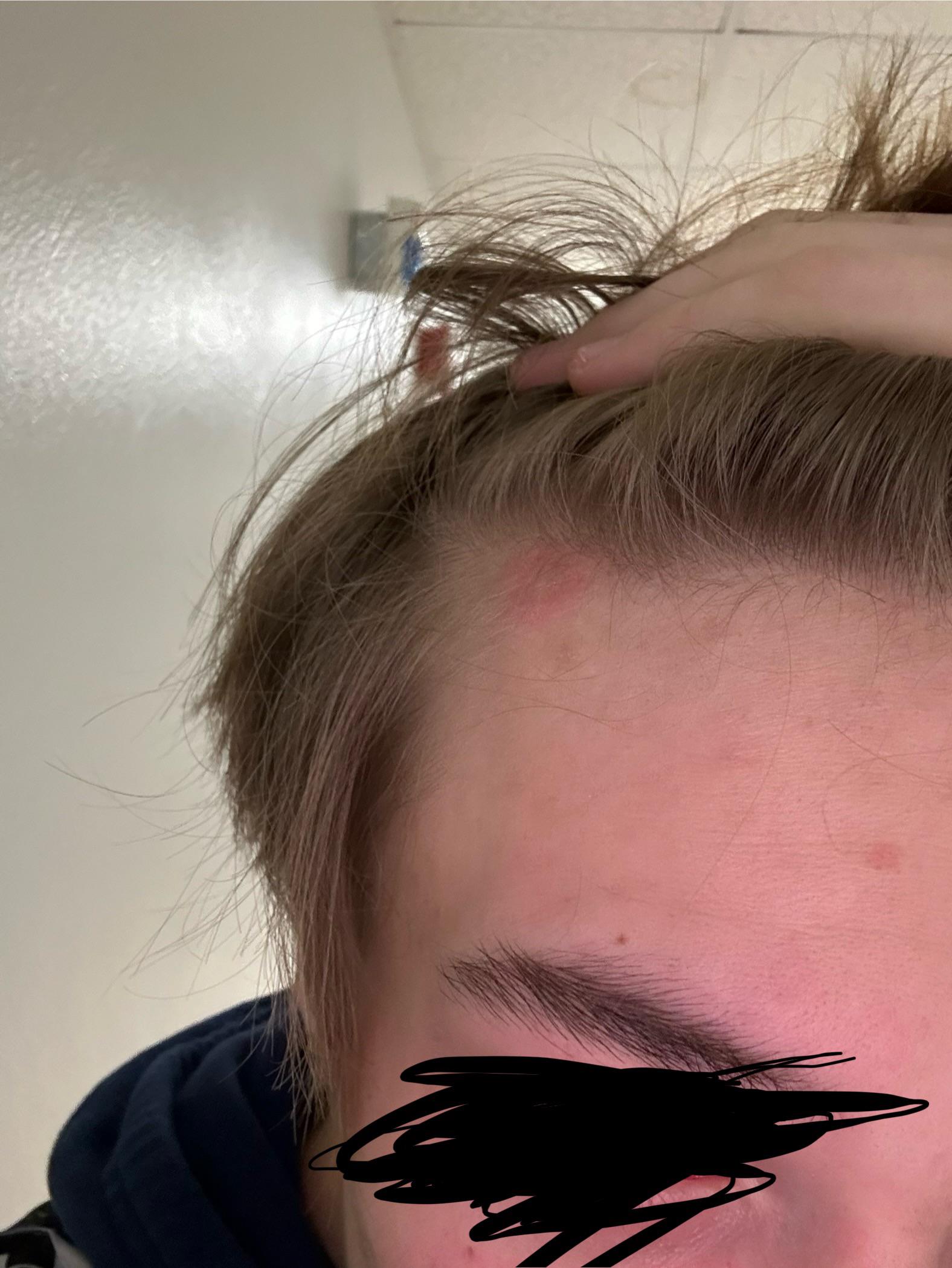 Is this ringworm? It’s a little itchy | Scrolller