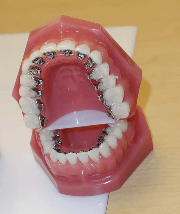 "Inside" braces | Scrolller