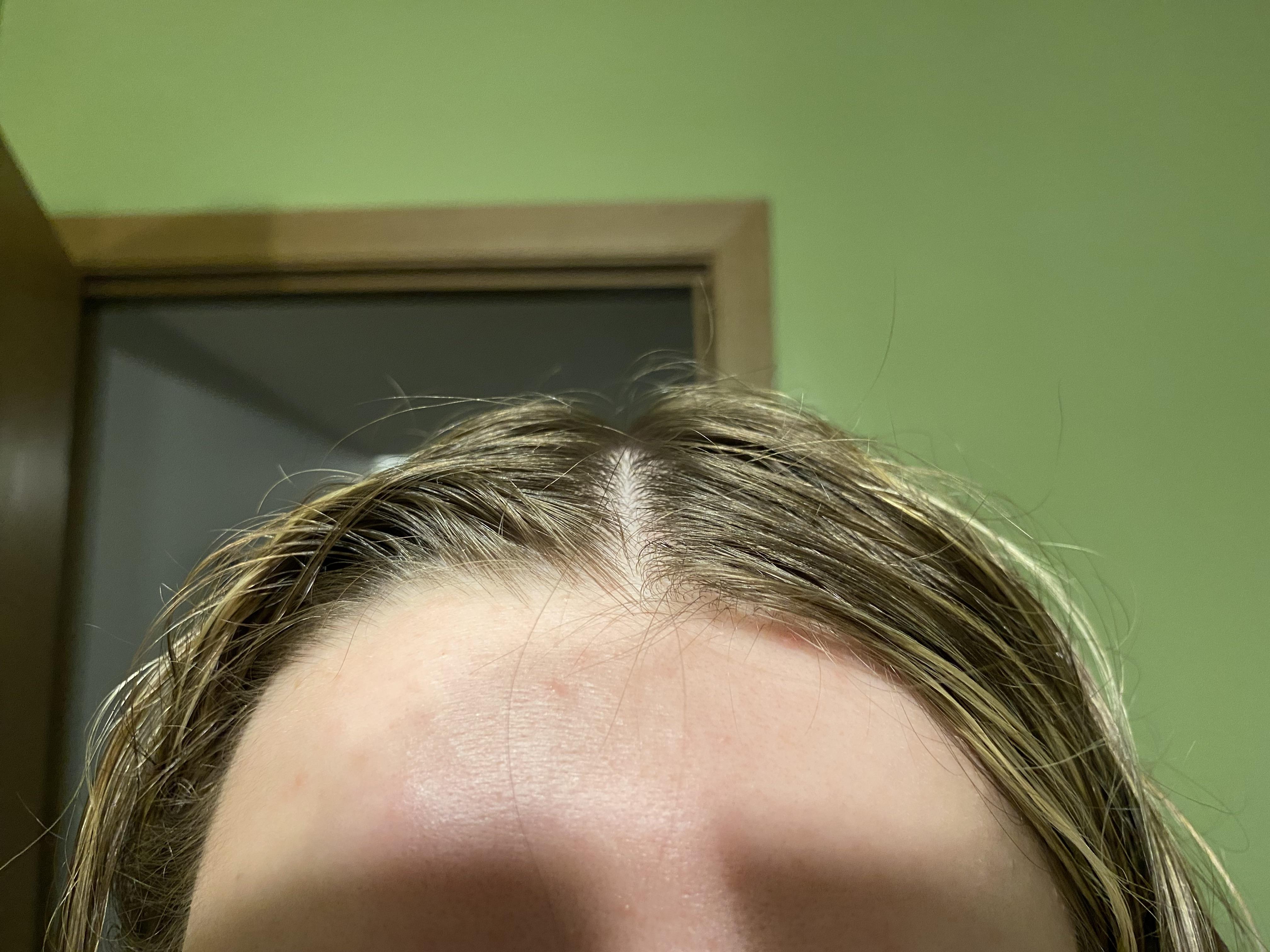 I have two different hair growth patterns on each side of my head | Scrolller