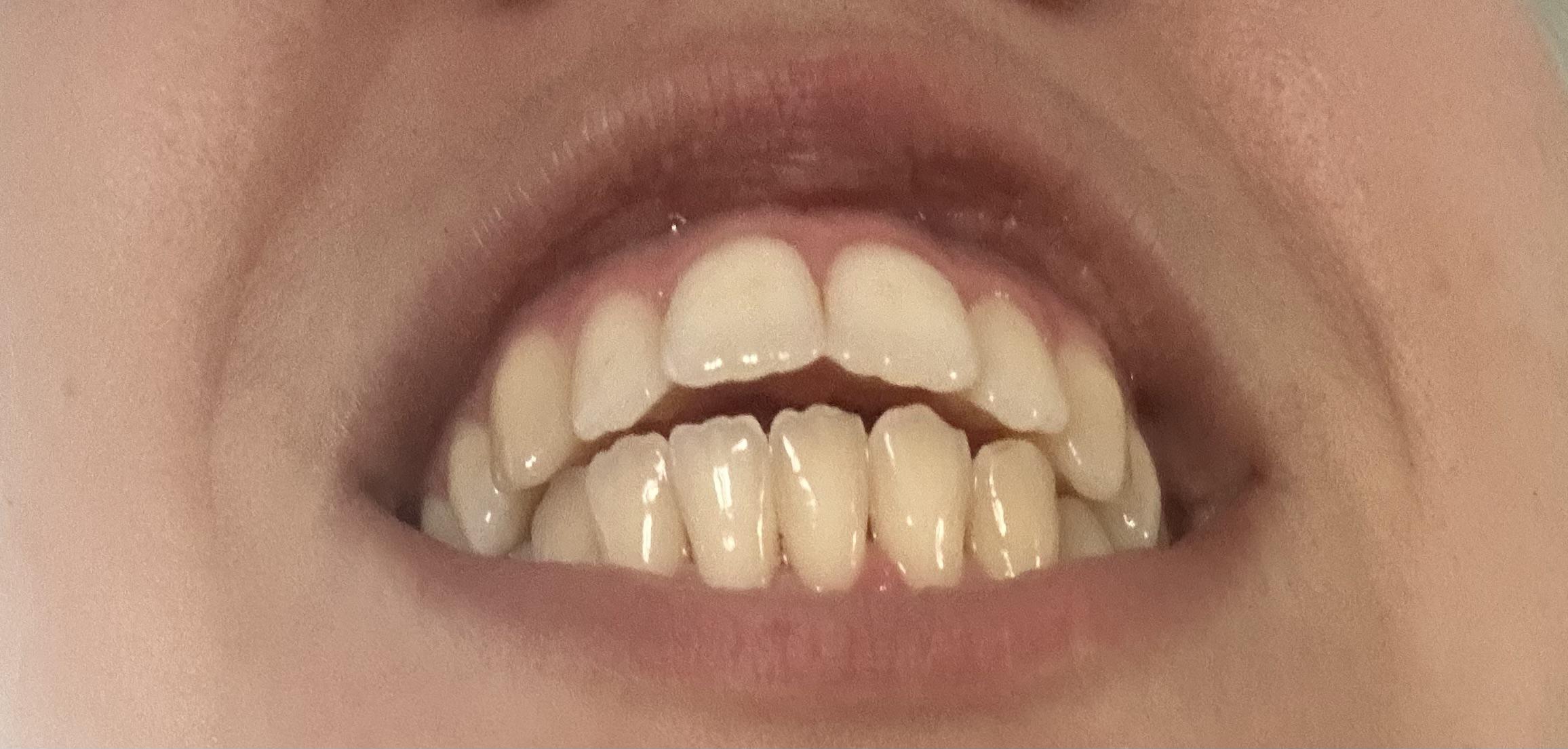 4 TEETH EXTRACTION AND BRACES FOR OVERJET | Scrolller