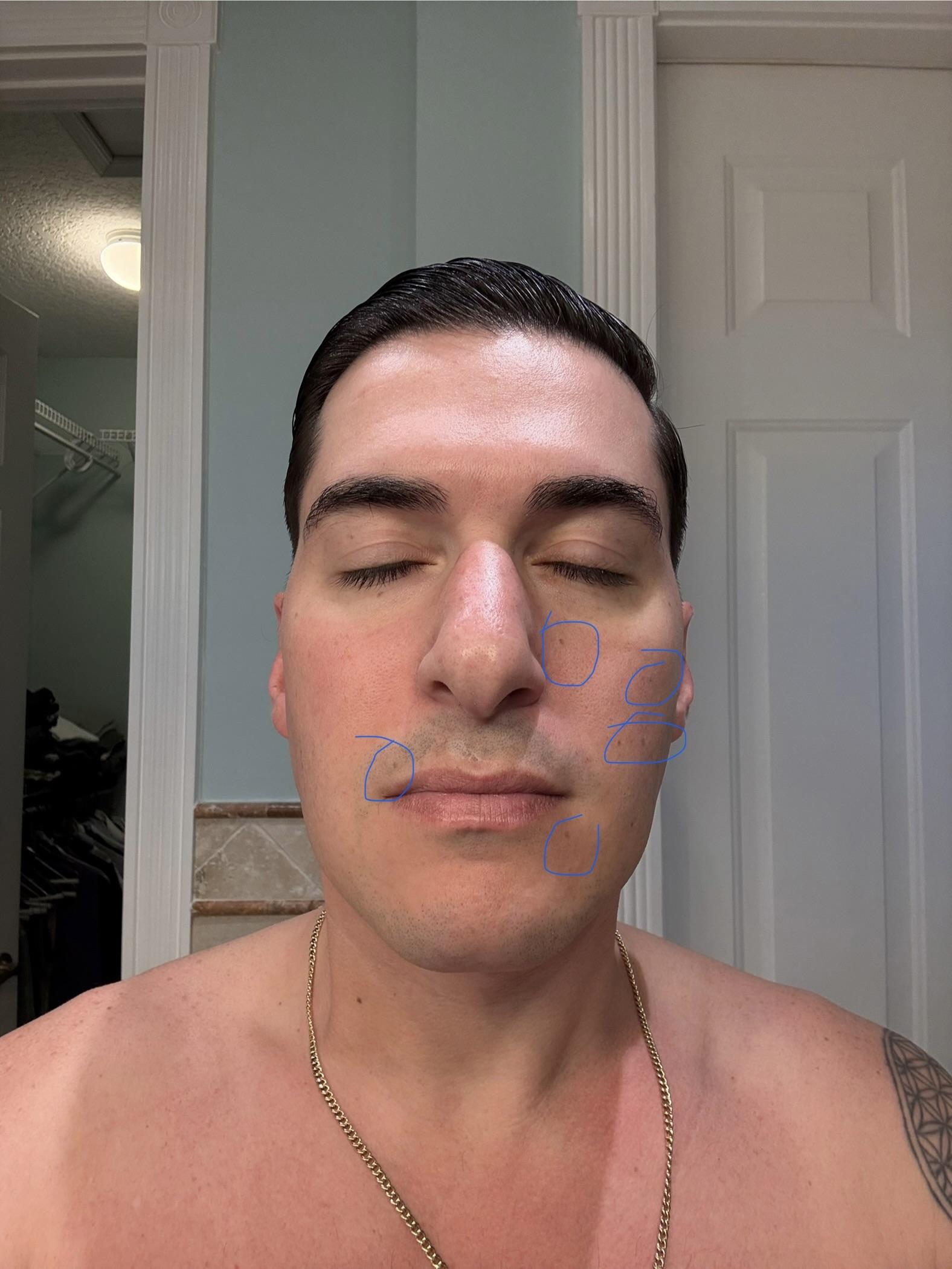 Update: Superficial CO2 DOT Laser | Scrolller