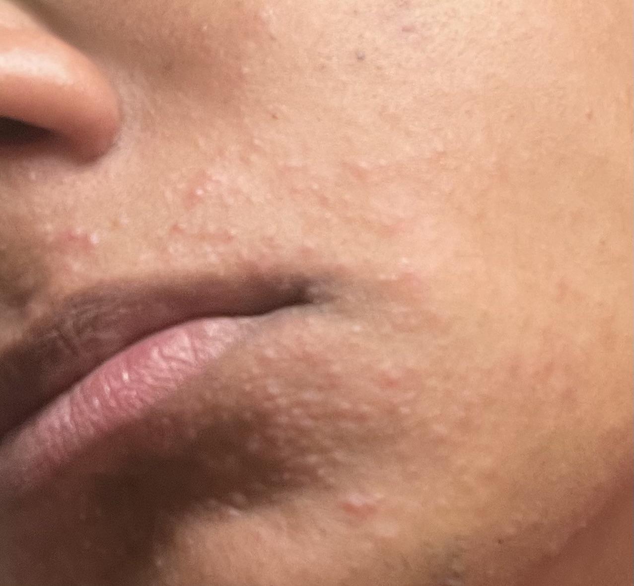 Small raised red bumps on face | Scrolller