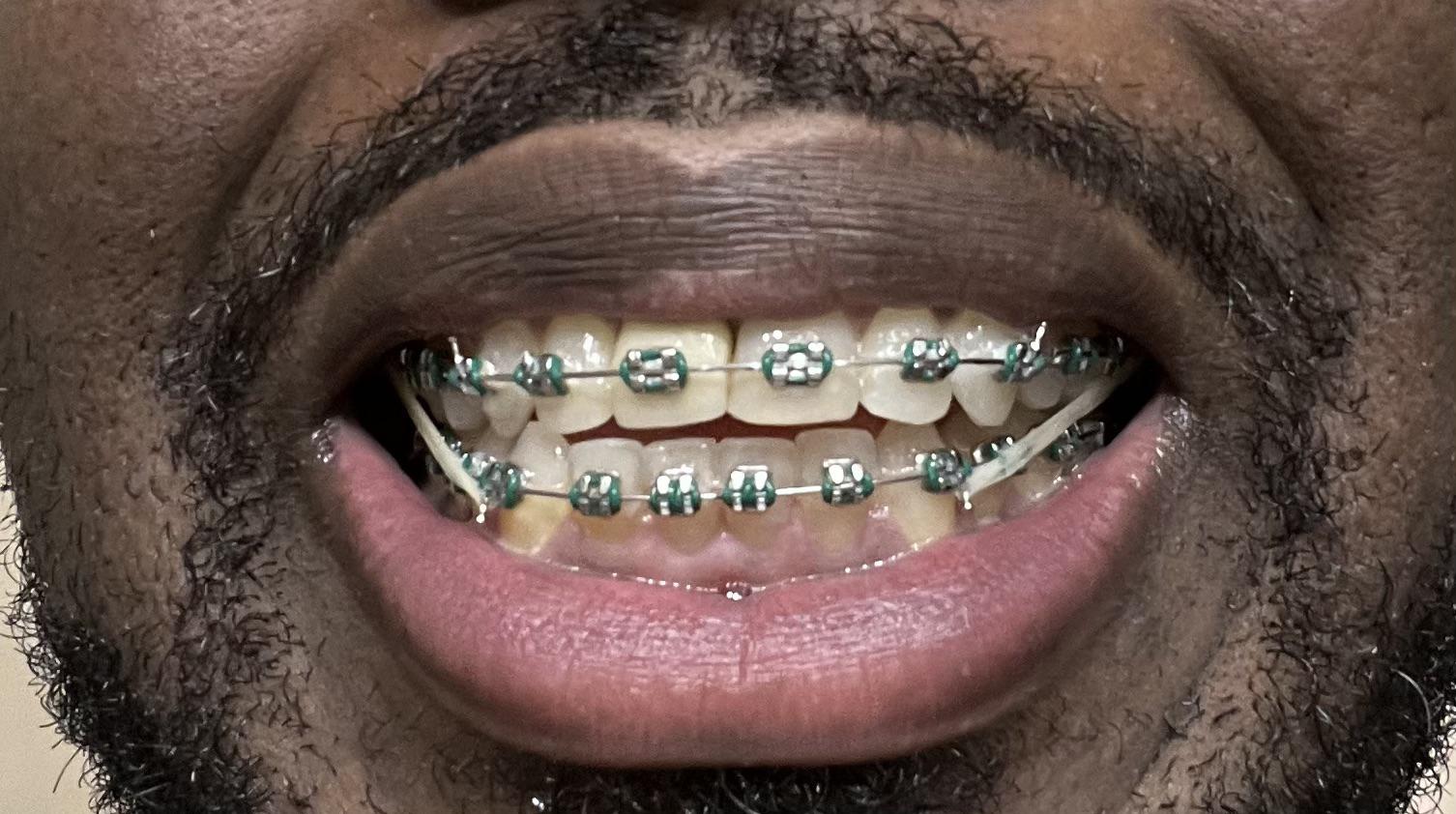 Over a year with braces. | Scrolller