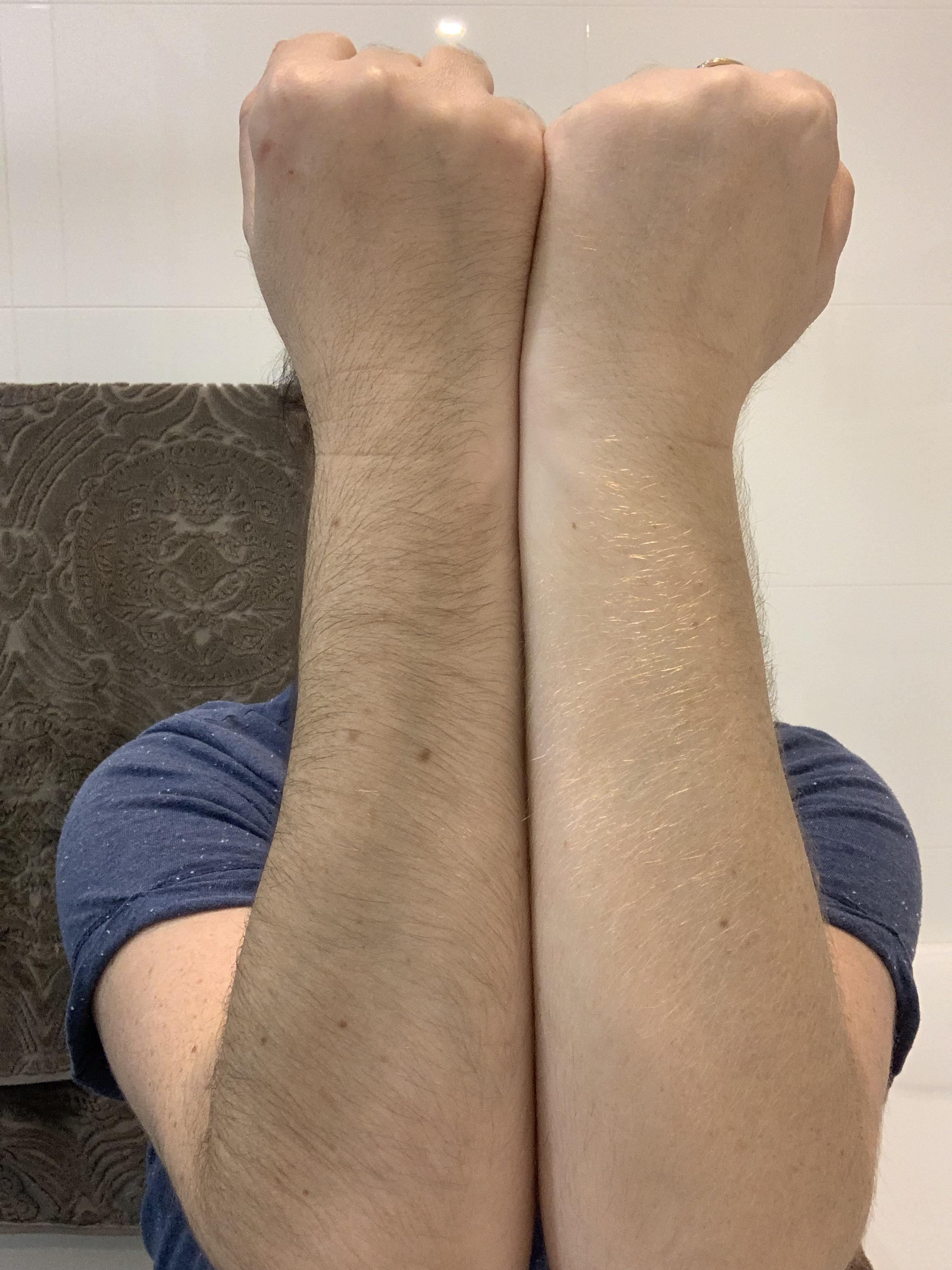 Halfway done bleaching the hair on my arms | Scrolller