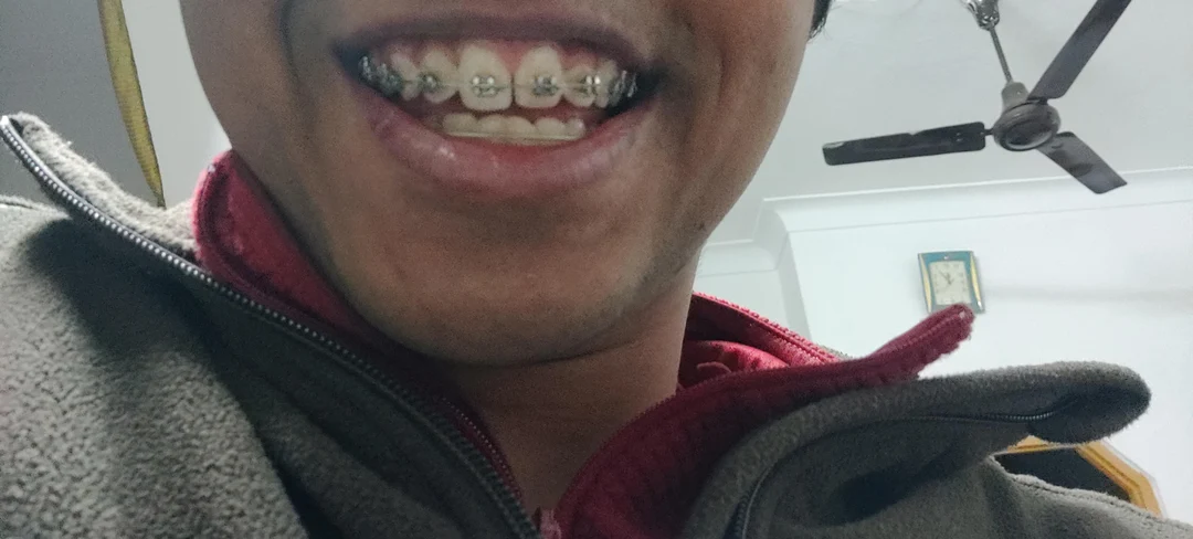 Gap in final stages of braces. Is this normal? I have never had a gap in my front teeth. | Scrolller