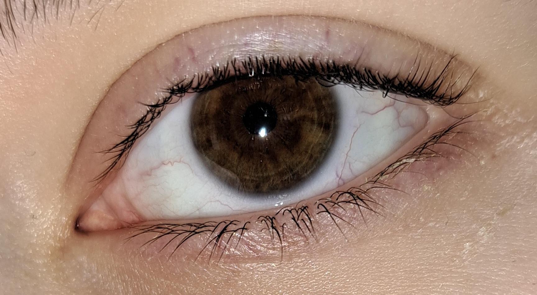 Can someone tell me what these rings are around my iris? | Scrolller