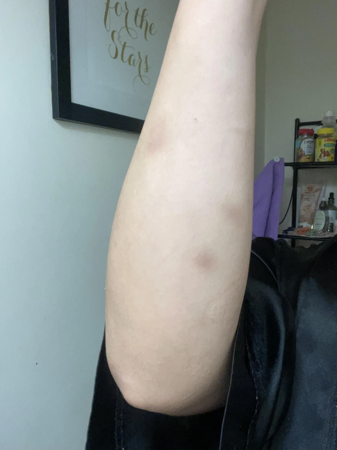 waking up with bruises on my arm?? | Scrolller