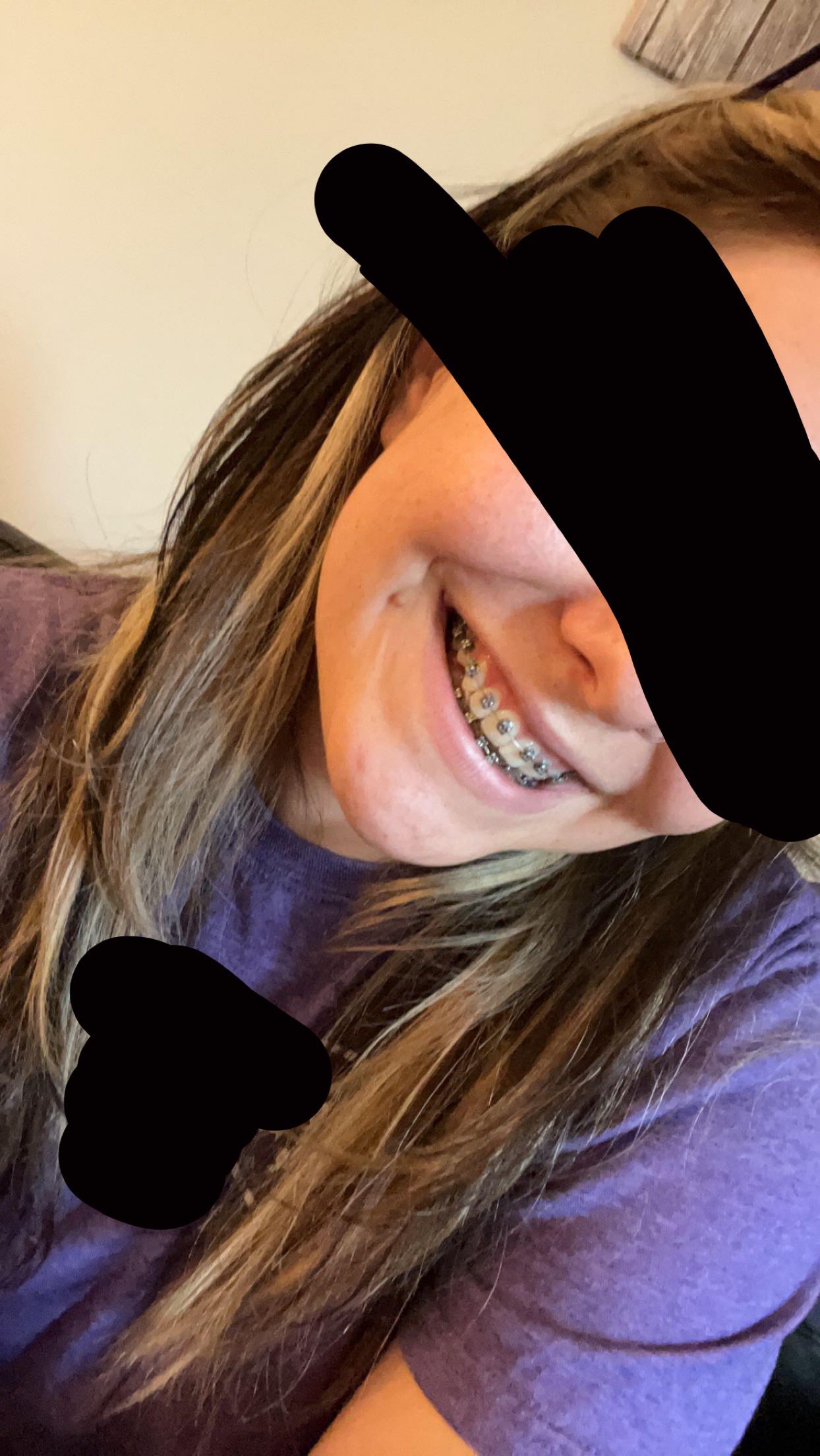 Day one of braces! | Scrolller