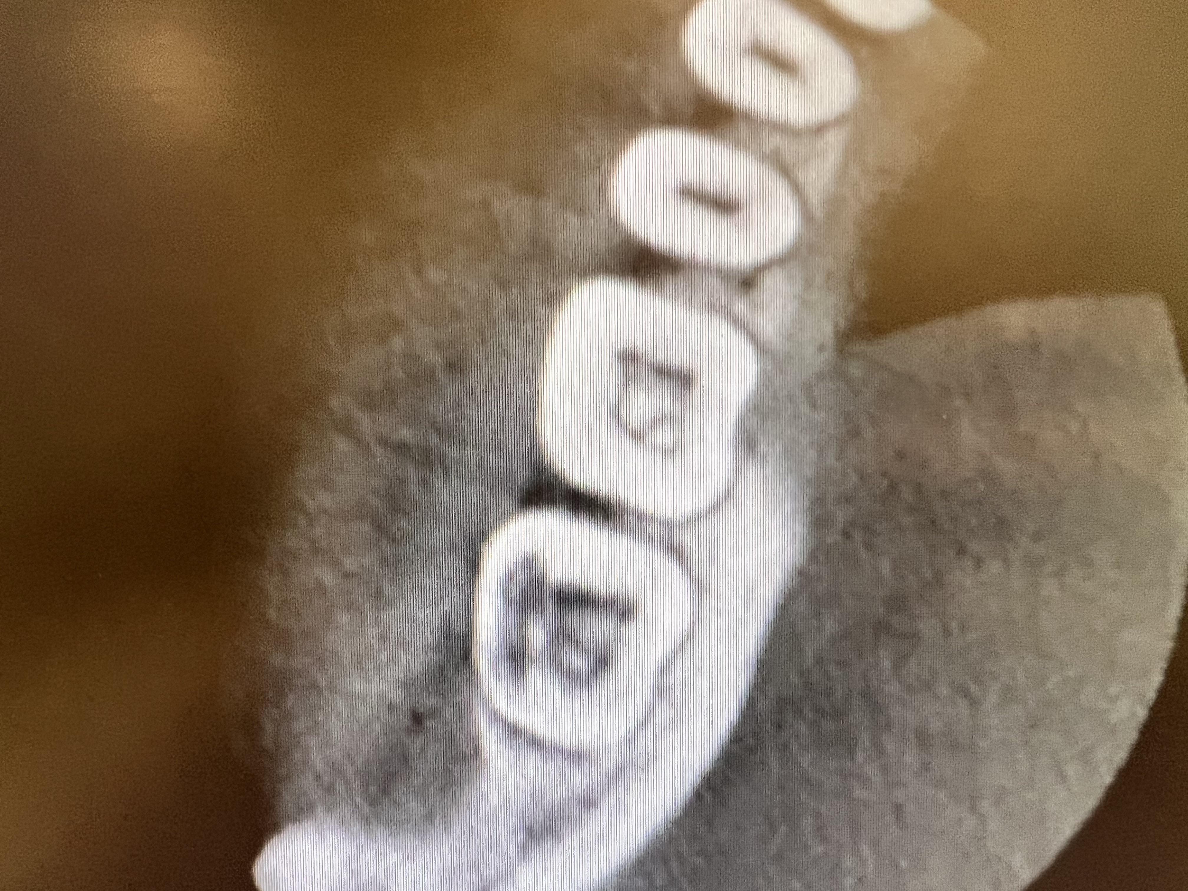 Internal Resorption | Scrolller