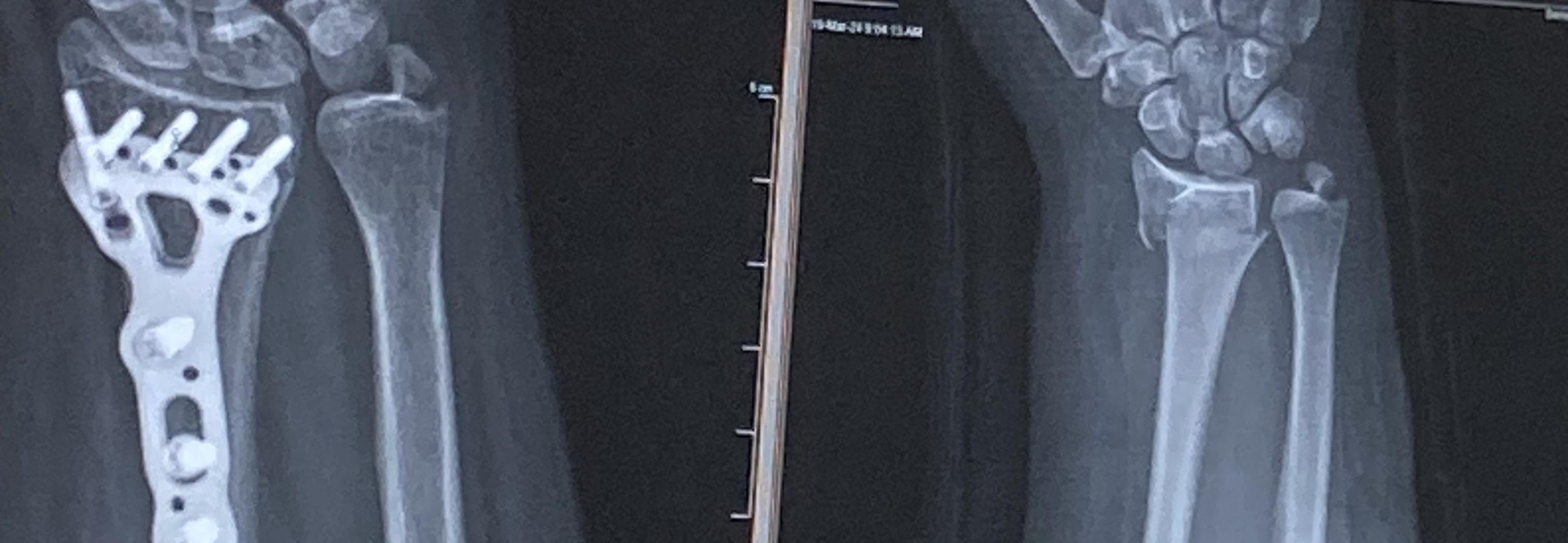 Distal radius fracture and recovery | Scrolller