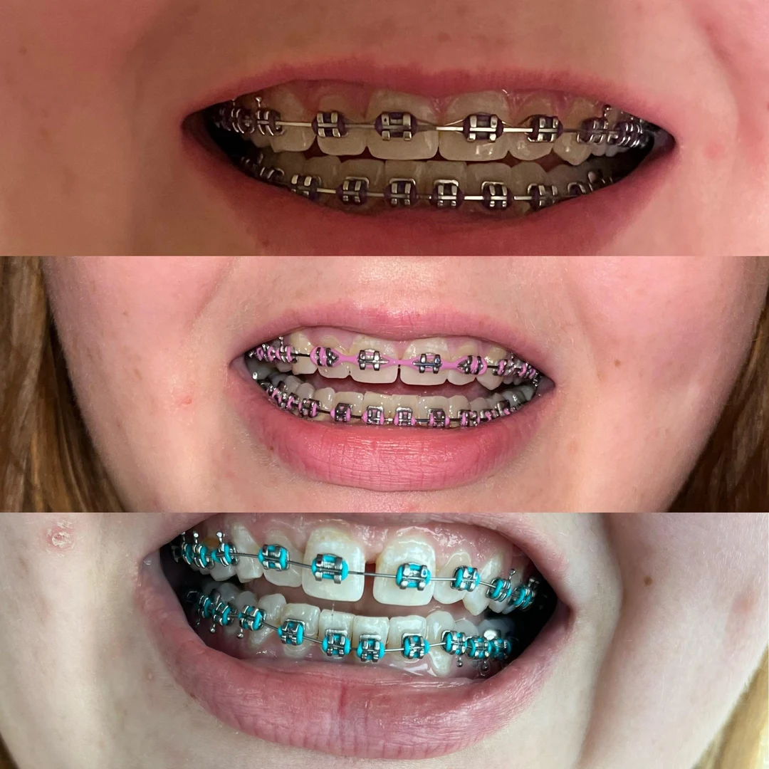6 months with braces | Scrolller