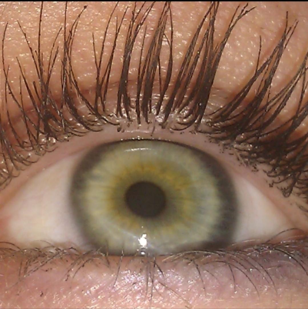Central Heterochromia? | Scrolller