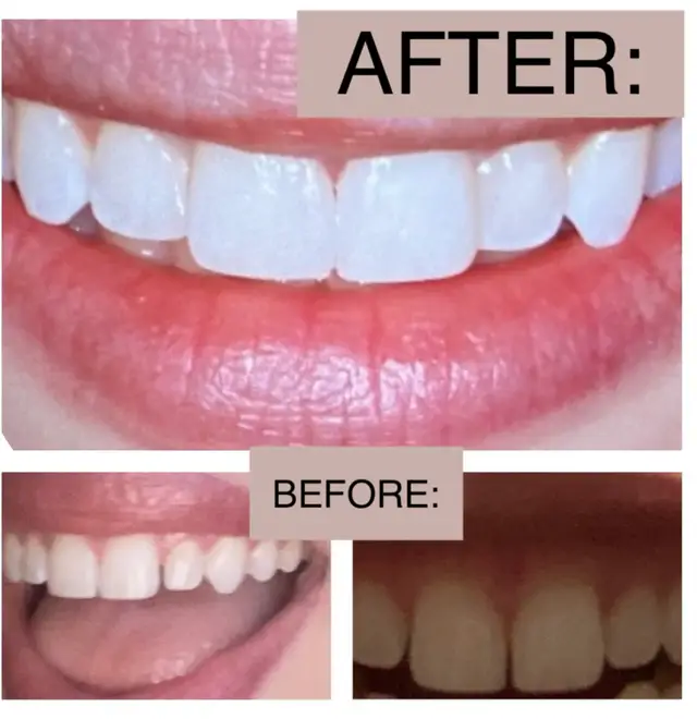 DENTAL BONDING QUESTION (had braces but never wore retainer) | Scrolller