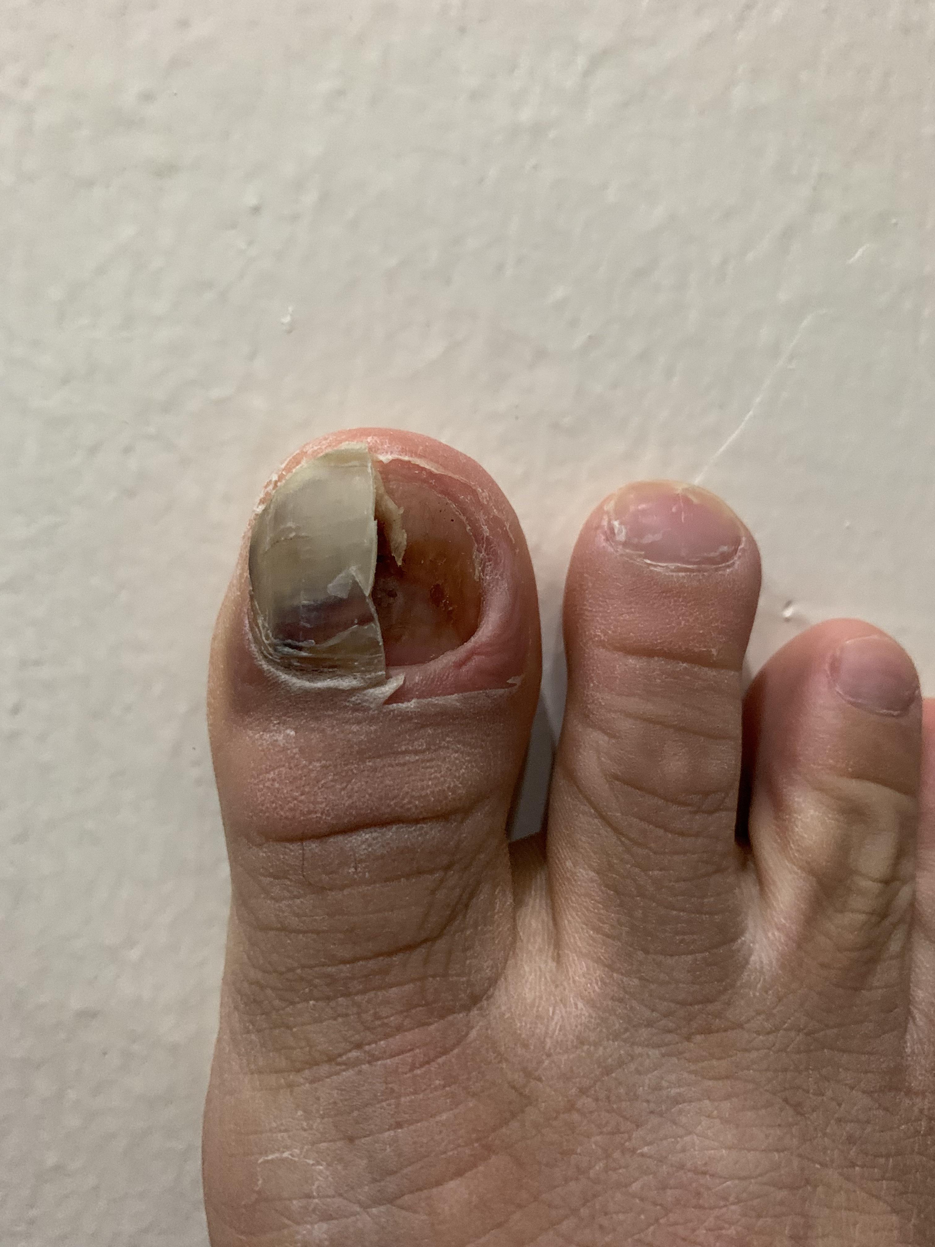 Broken toenail with half still attached | Scrolller
