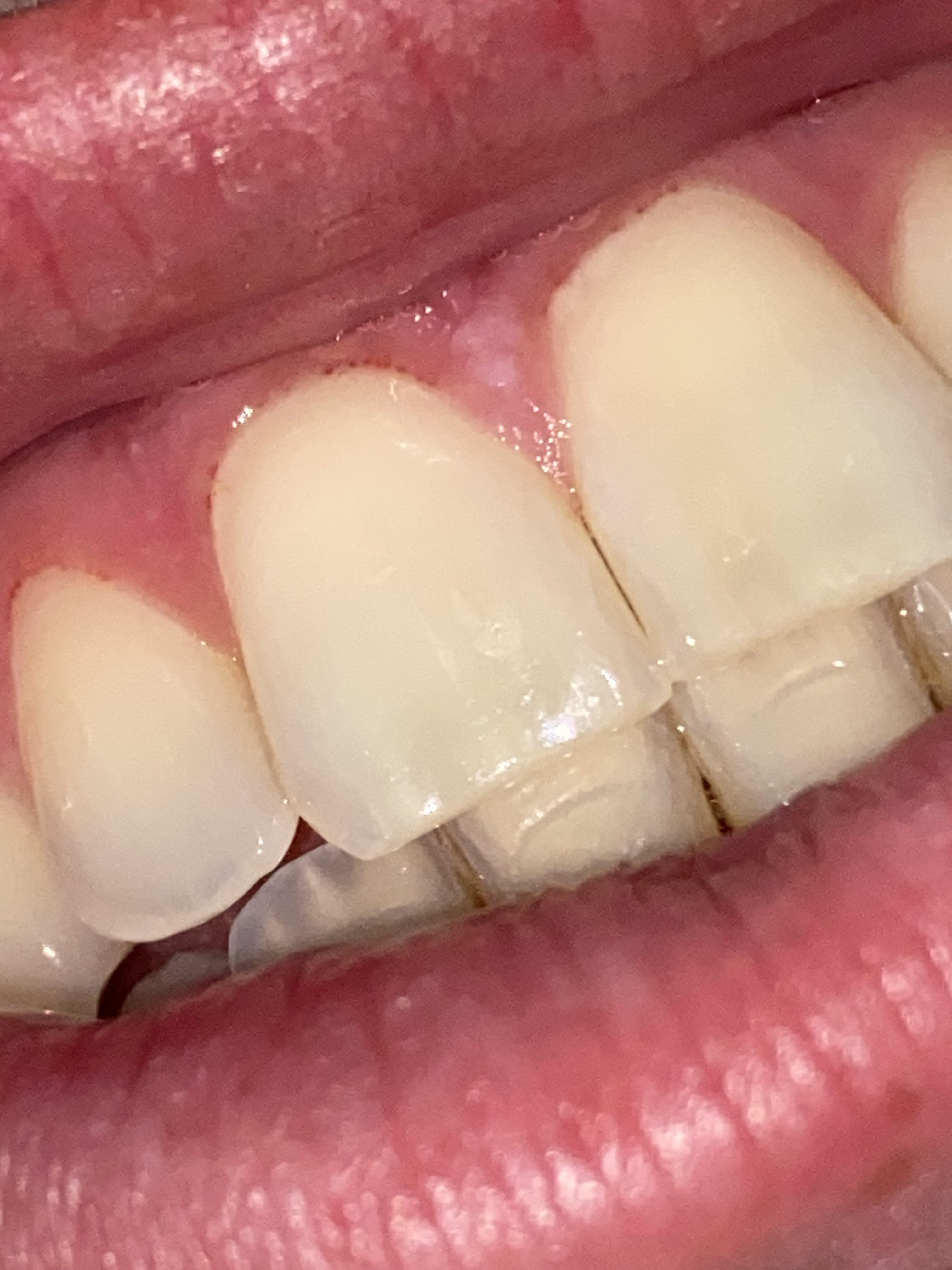 Red dots around teeth | Scrolller