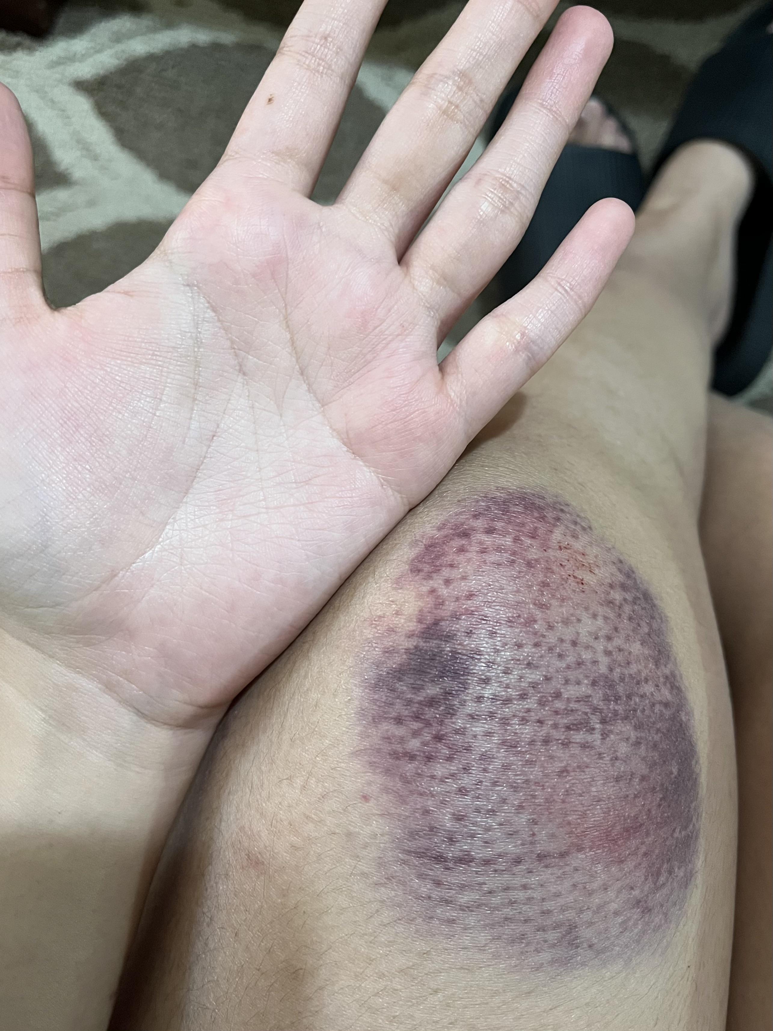 The massive bruise on my left knee. | Scrolller