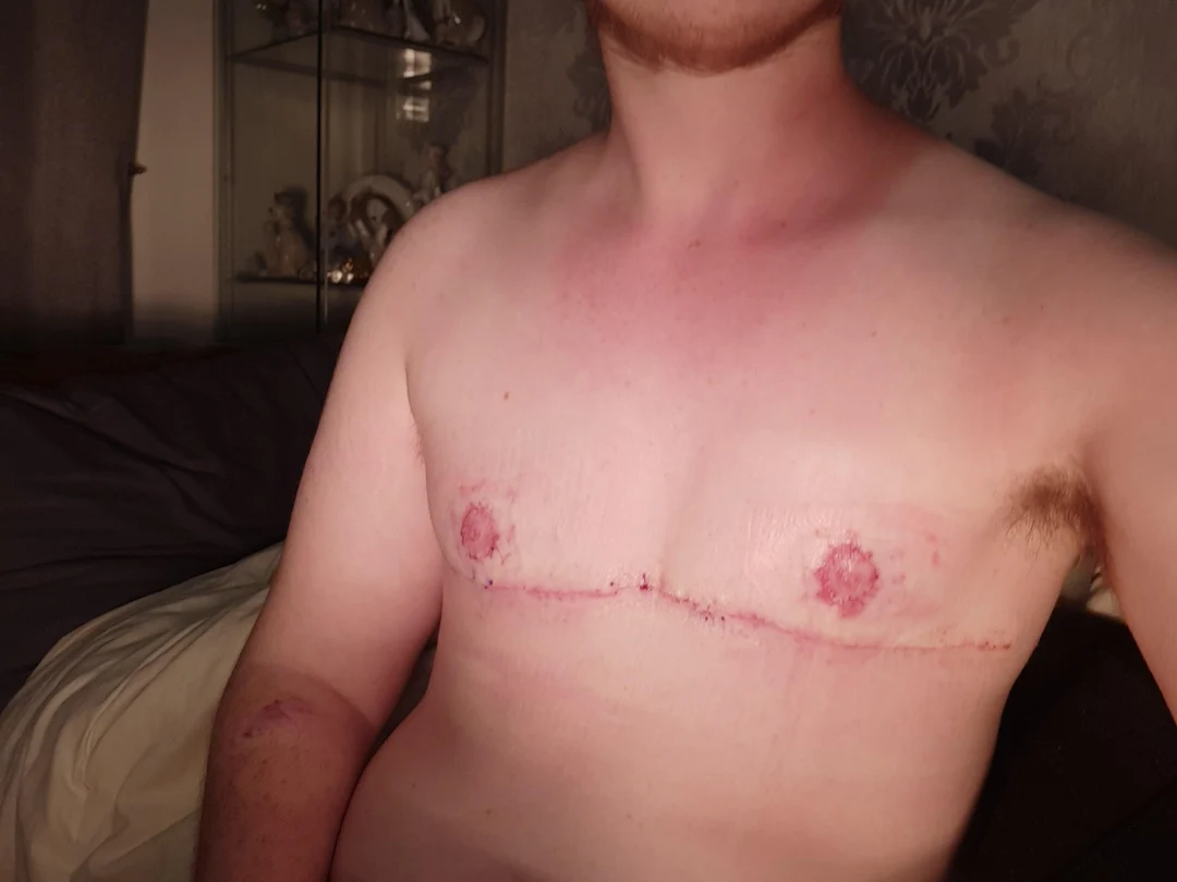 3 weeks post op | Scrolller
