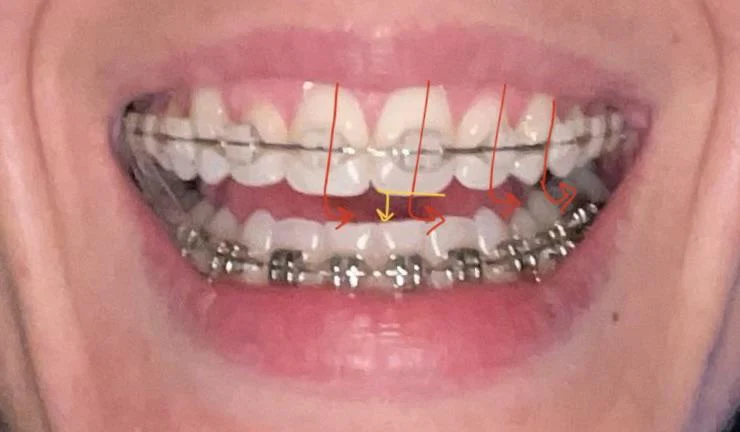 Slanting teeth: is this a normal phase? | Scrolller