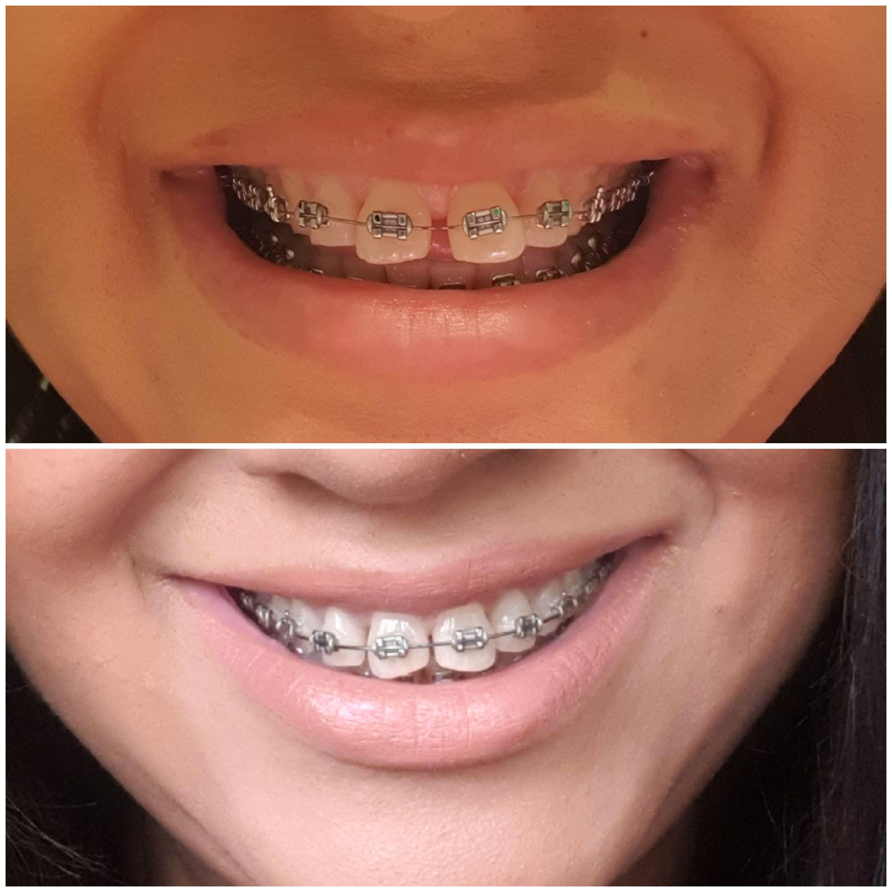 Three months in and loving the progress so far. can't believe how quickly my gap is closing ...