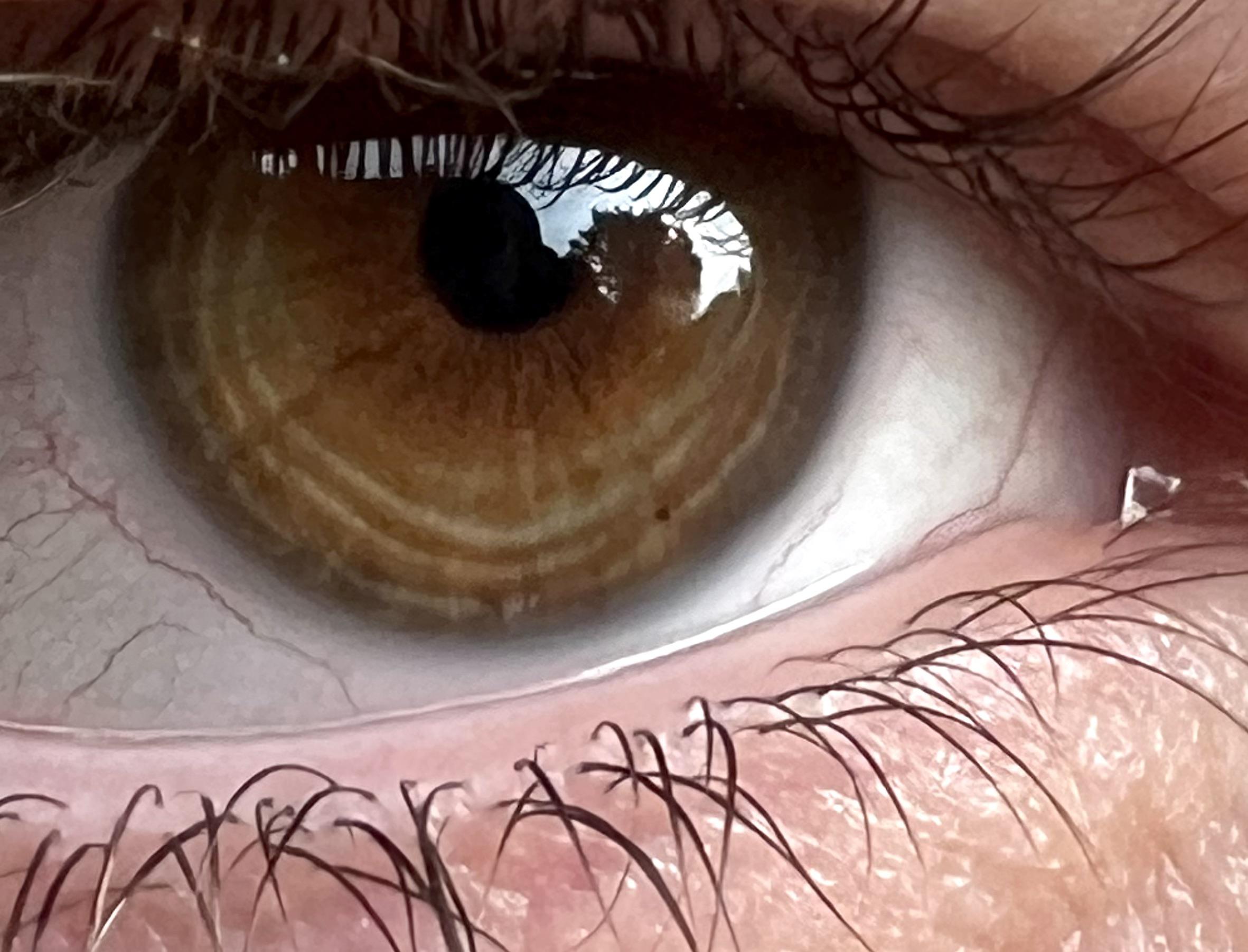 Light rings surrounding pupil on brown eyes? | Scrolller