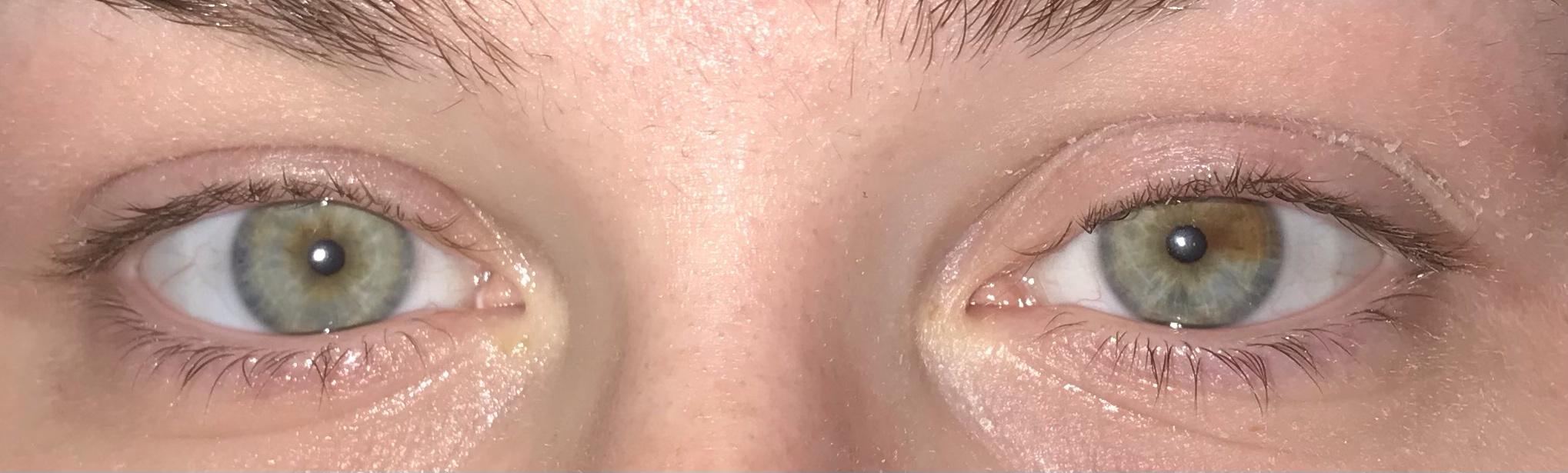 Ignore the flaky skin I’ve had an allergic reaction to some lash glue recently. | Scrolller