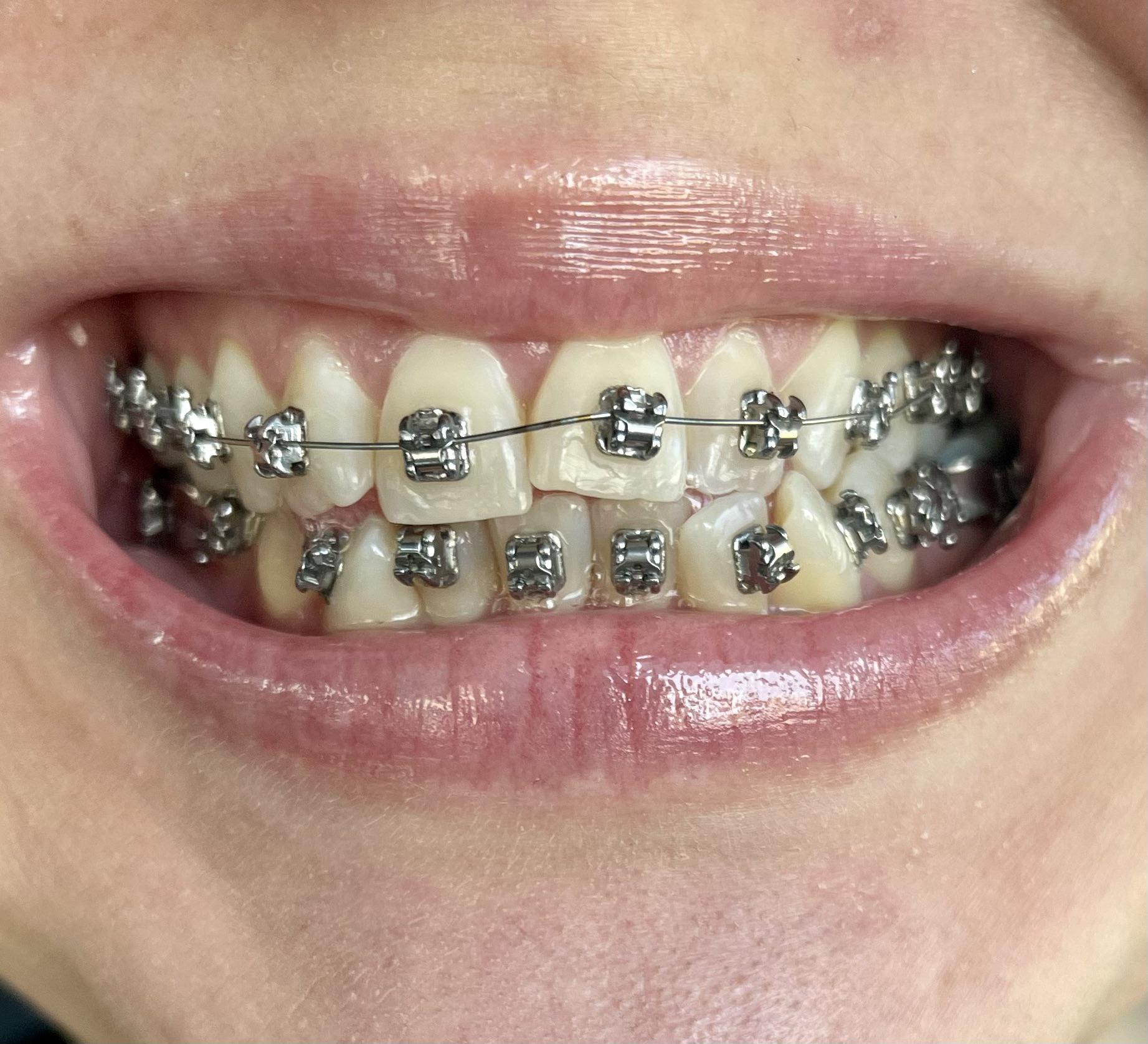 Braces Journey Week 1 Scrolller