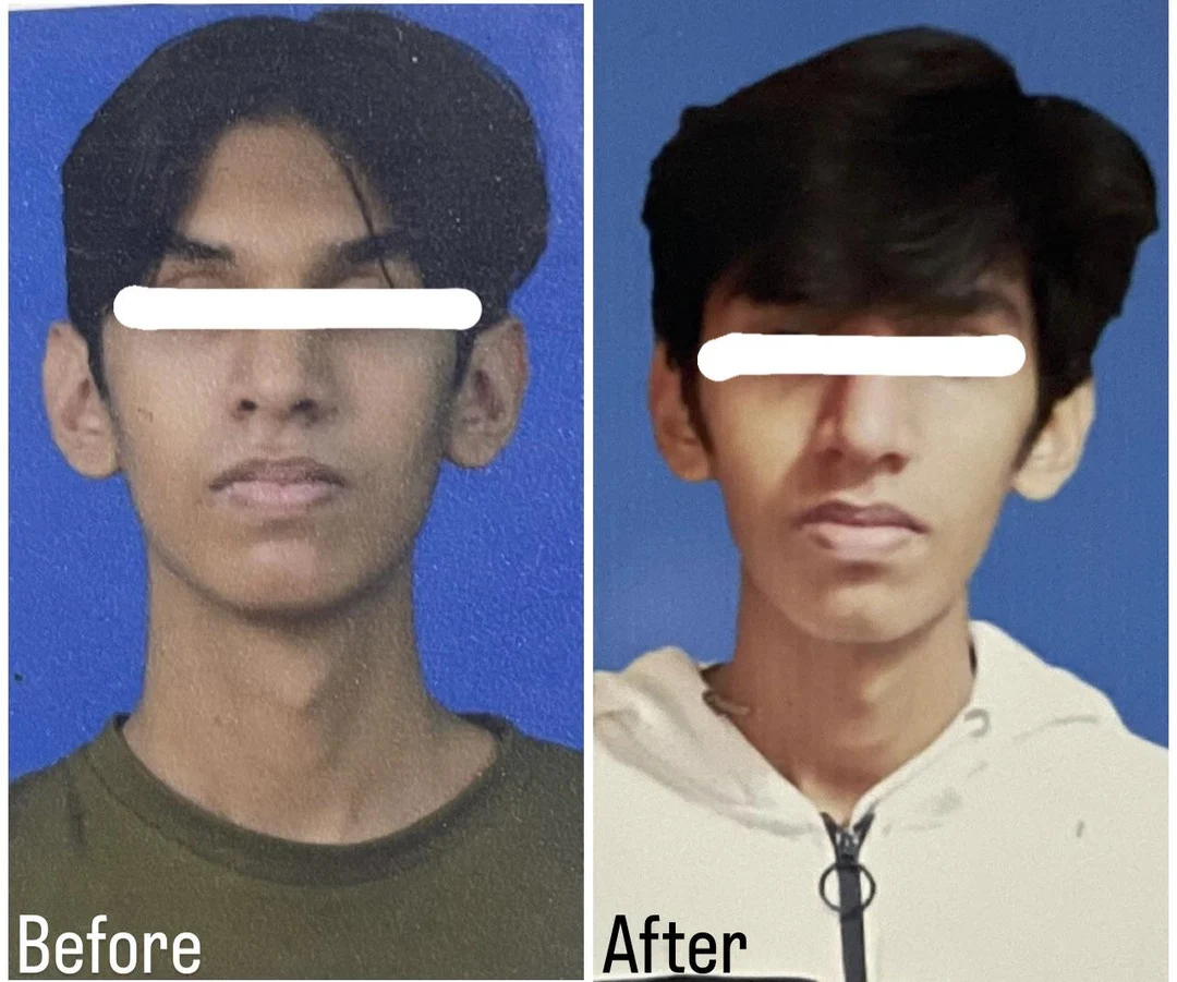 Braces and Extractions | Scrolller