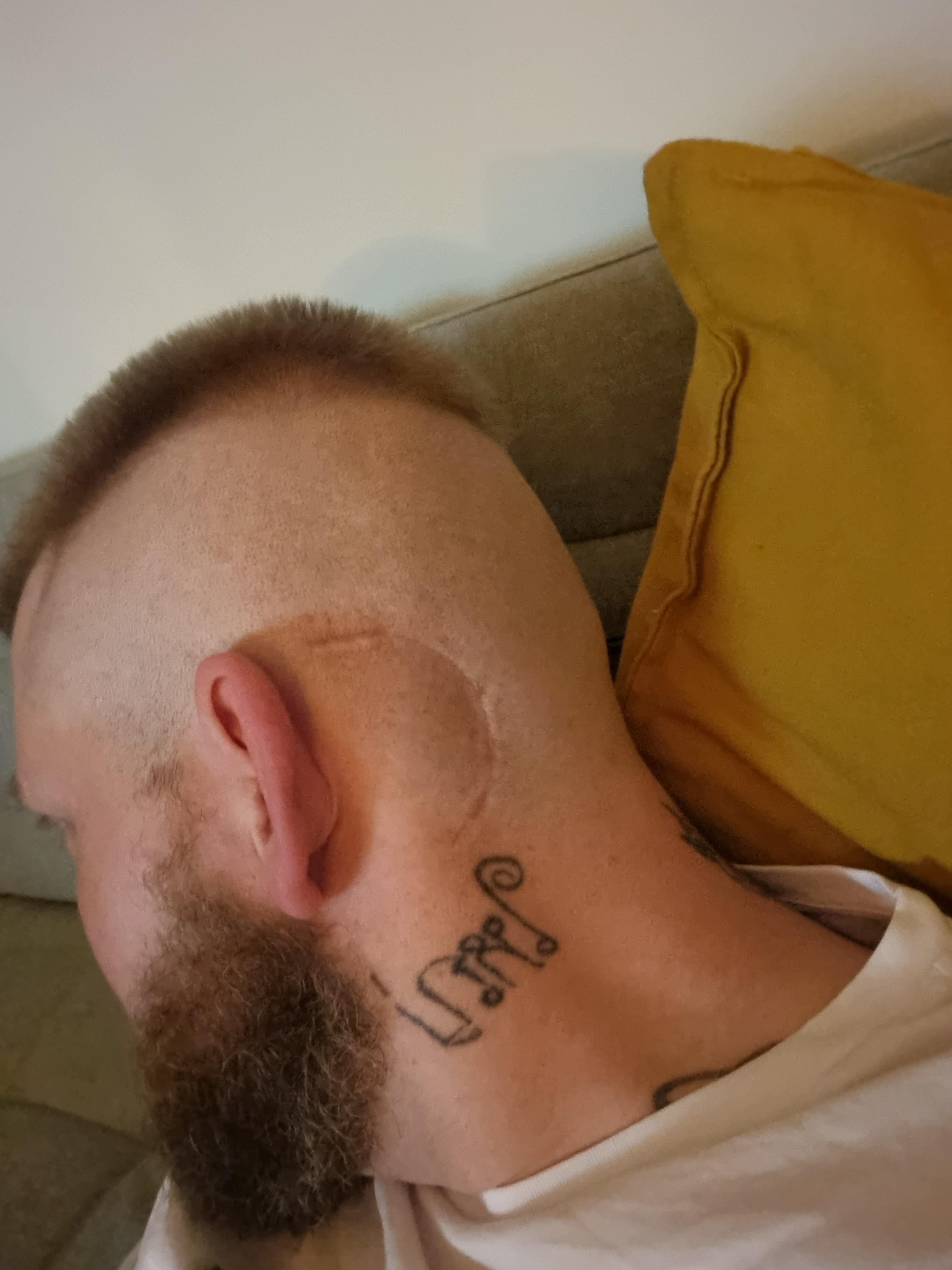 Brain surgery scar 6 months post op | Scrolller